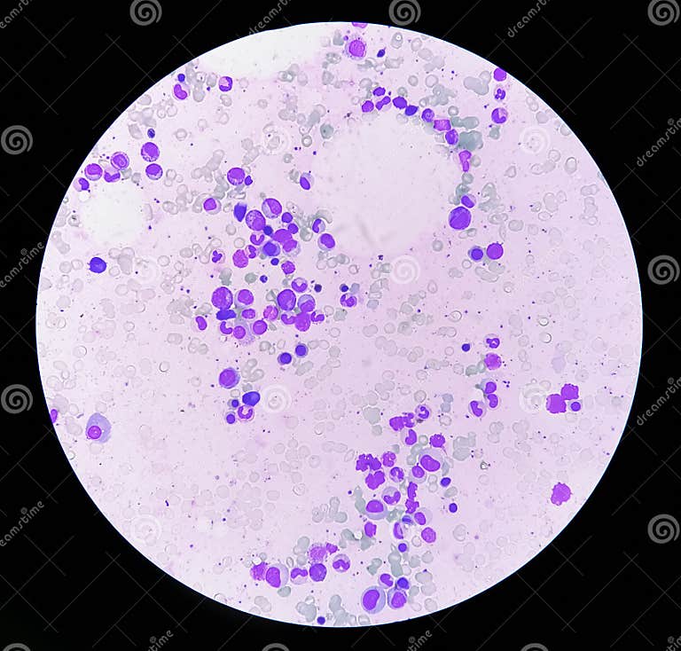 Bone Marrow Study: Suggestive of Reactive Marrow with Dimorphic ...