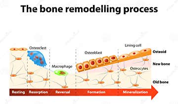 Bone remodelling process stock vector. Illustration of cells - 61582324