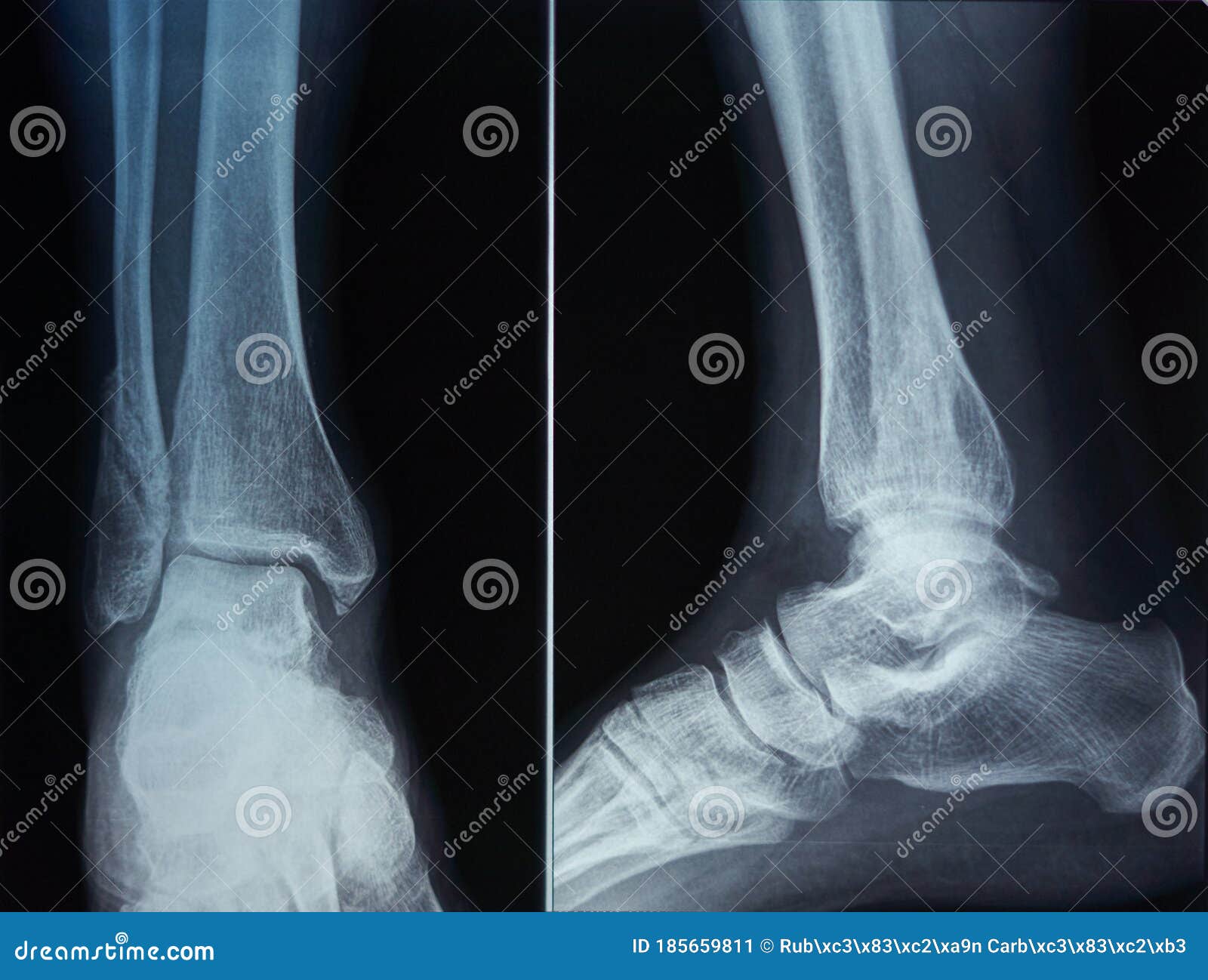 Bone scan of a foot stock image. Image of health, hospital - 185659811