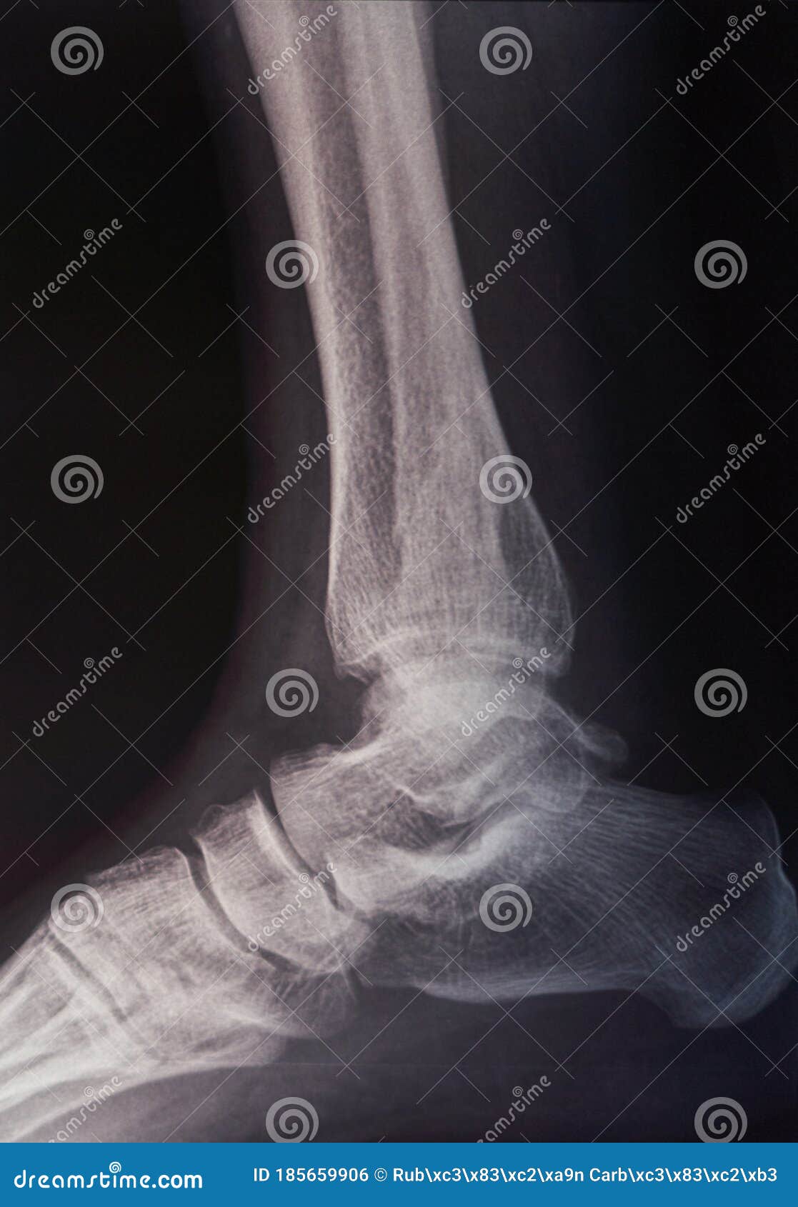 Bone scan of a foot stock photo. Image of physical, joint - 185659906