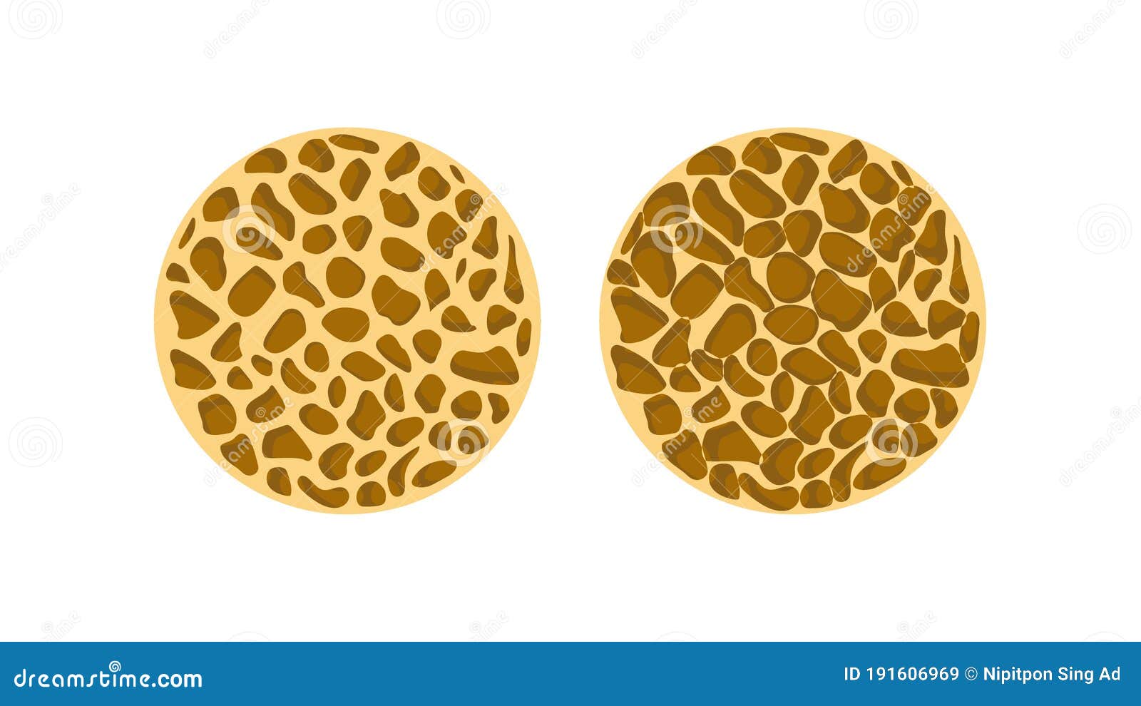 Bone Spongy Structure, Normal And With Osteoporosis Royalty-Free Stock ...