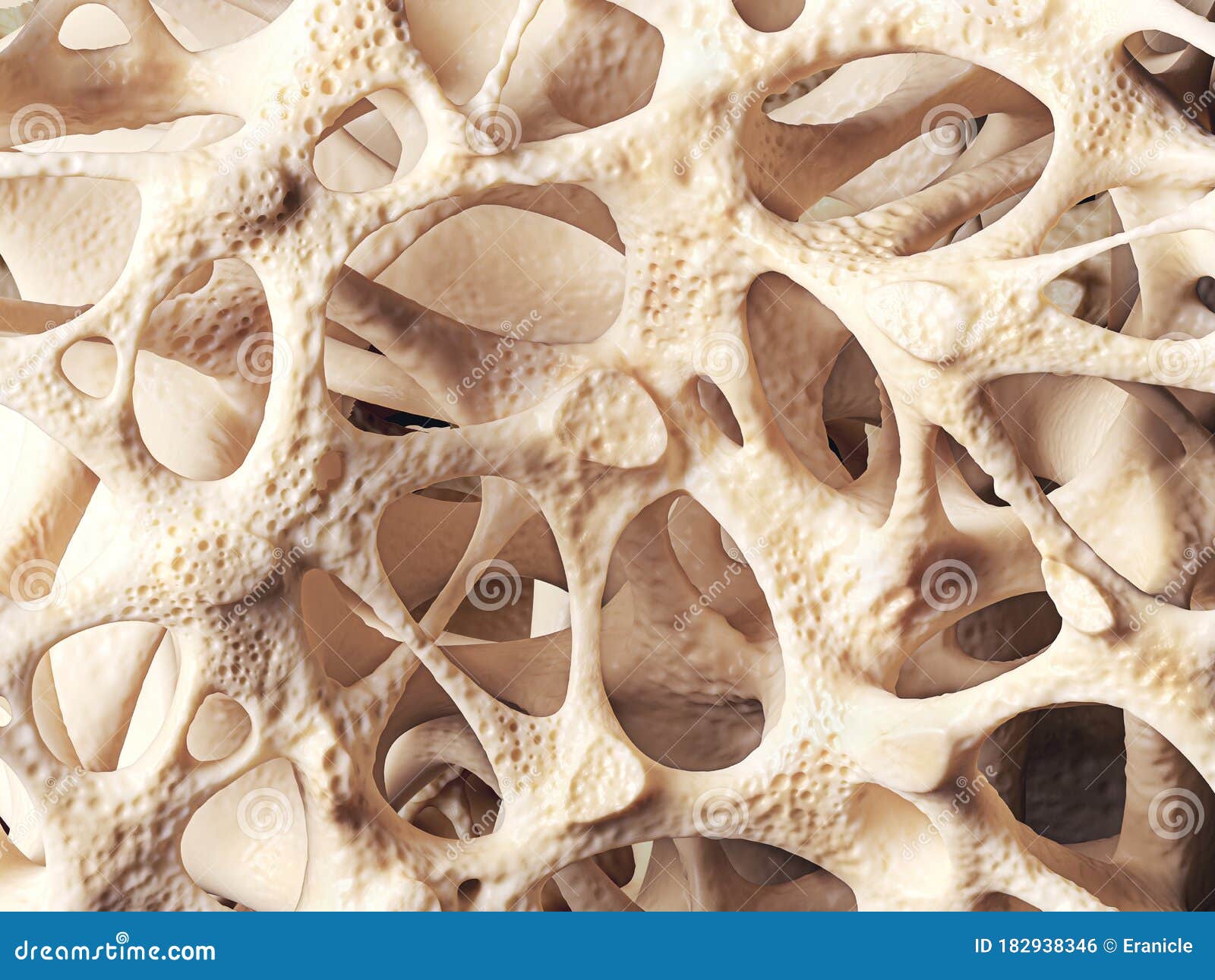 Bone Structure With Osteoporosis Royalty-Free Cartoon | CartoonDealer ...