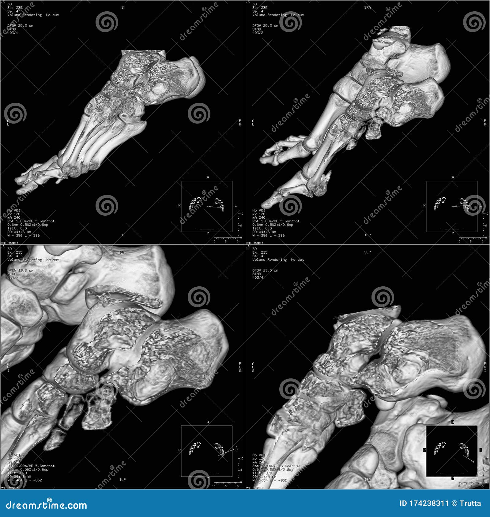 CT foot image stock image. Image of medicine, scanner - 174238311