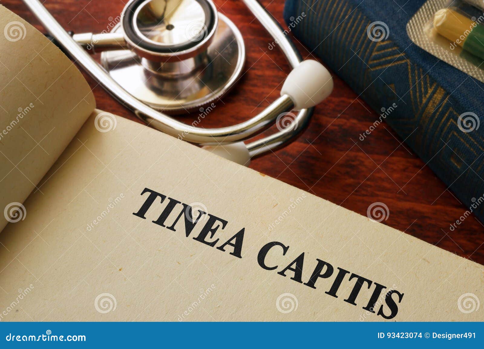 Tinea Capitis Or Fungal Infection On The Scalp Stock Photo ...