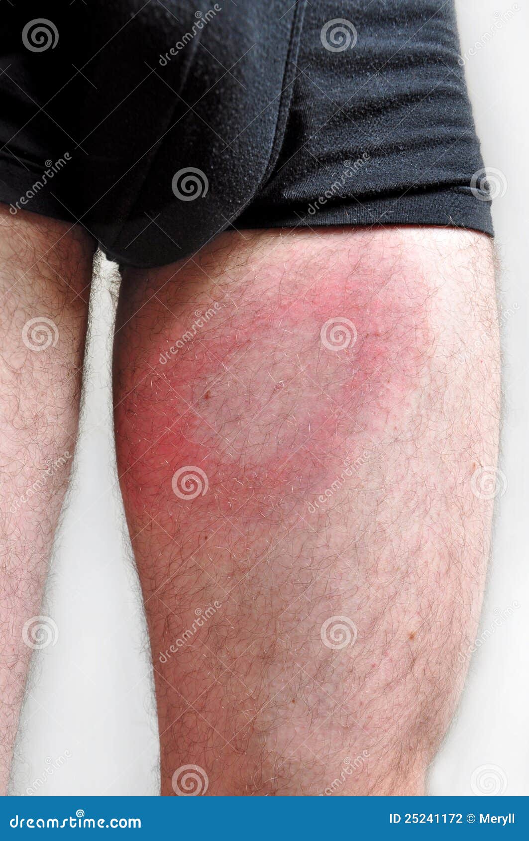 Borrelia Bacterial Infection Stock Photo - Image of parasitism, sign ...