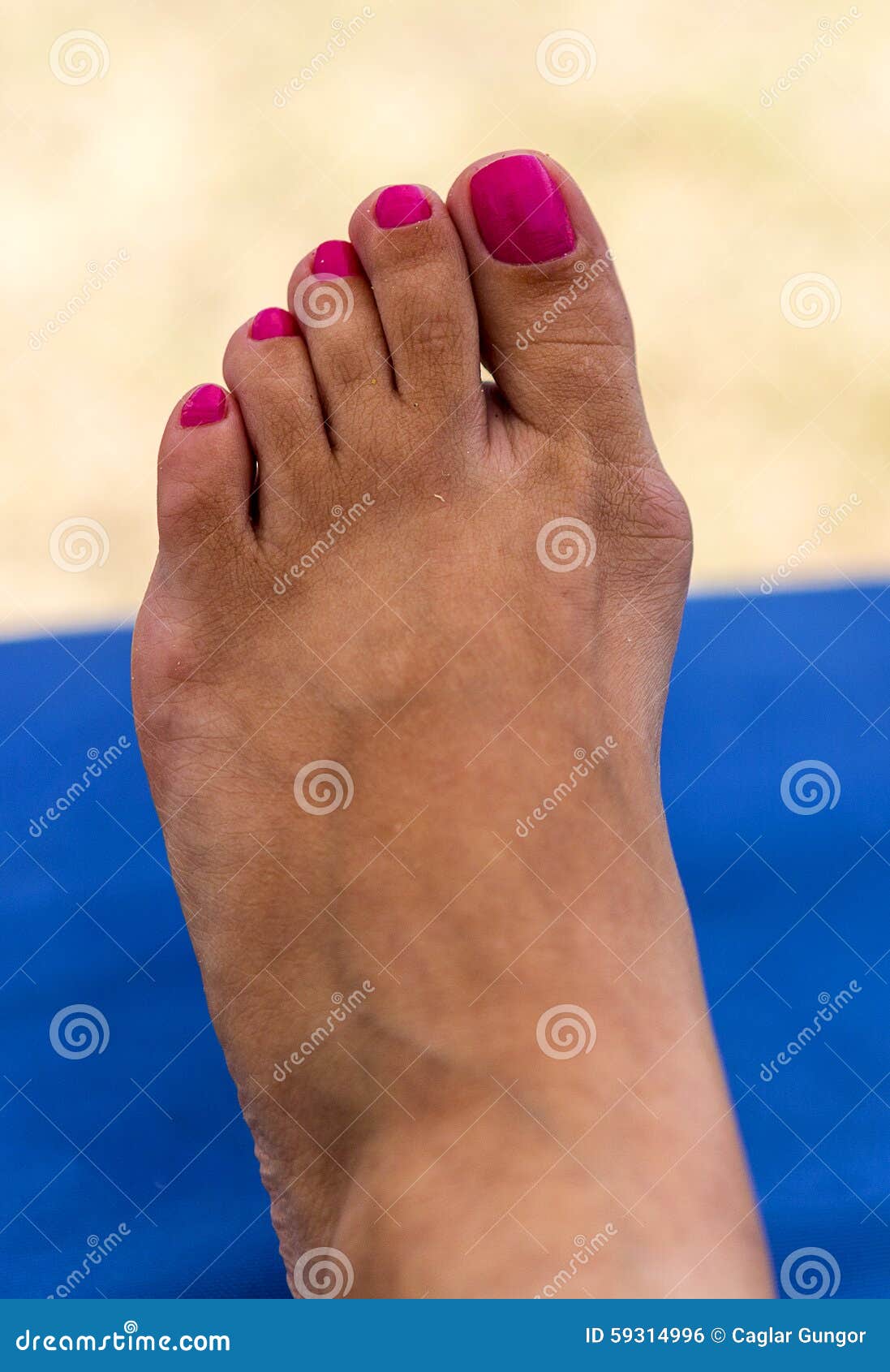 Borsite Dell'alluce - Alluce Valgo Fotografia Stock - Immagine di ...