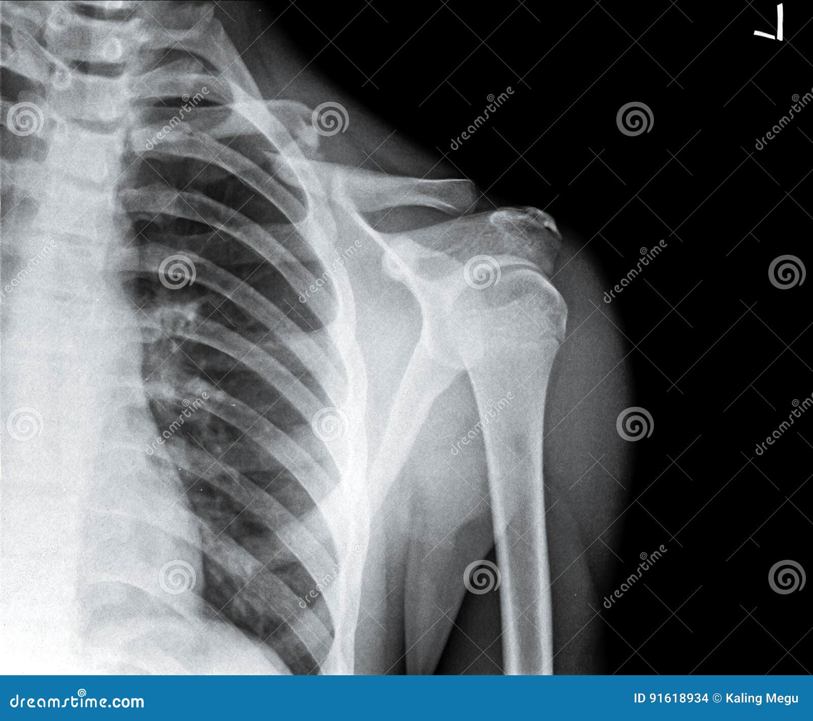 Borströntgenstraal Met Gebroken Sleutelbeen Stock Foto - Image of ...