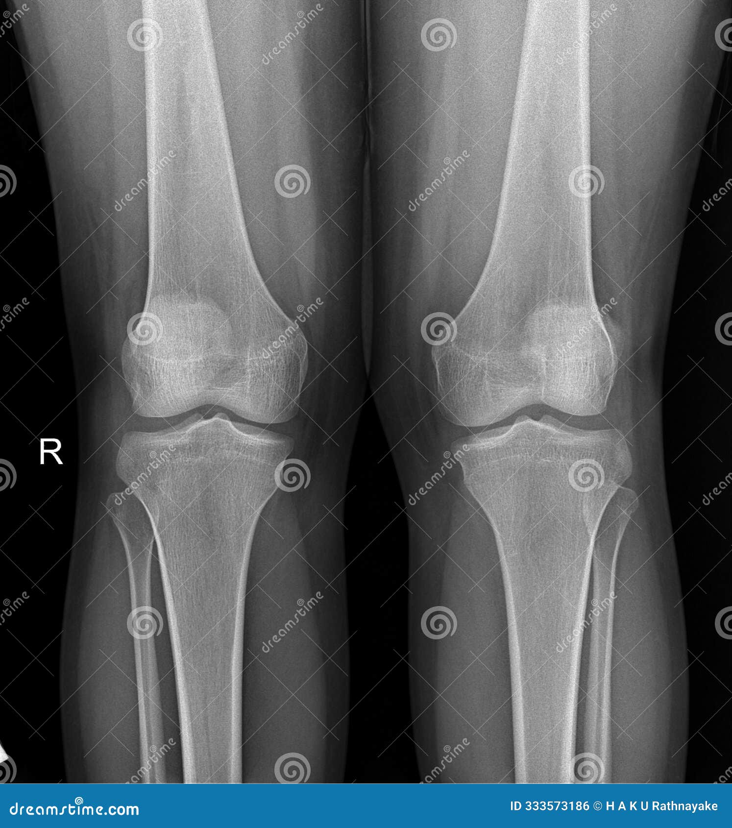 Both Knee X-Ray: Diagnostic Evaluation of Bone Structure Stock Photo ...