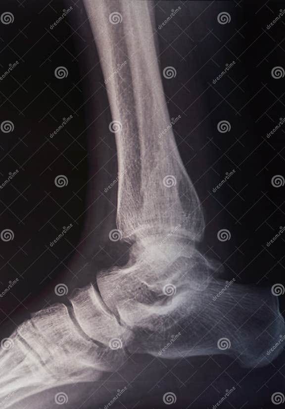 Botscan van een voet stock foto. Image of preventie - 185659906