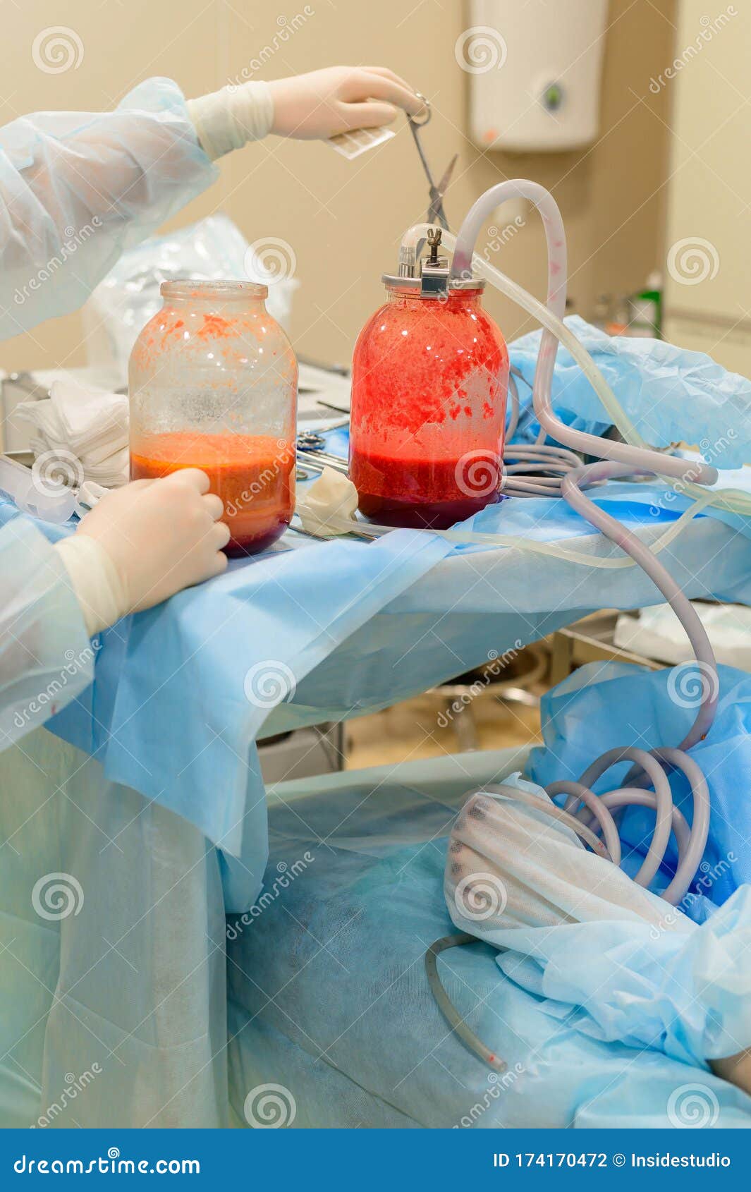 Bottle of Liquid Fat from Liposuction. Slimming through Plastic Surgery ...