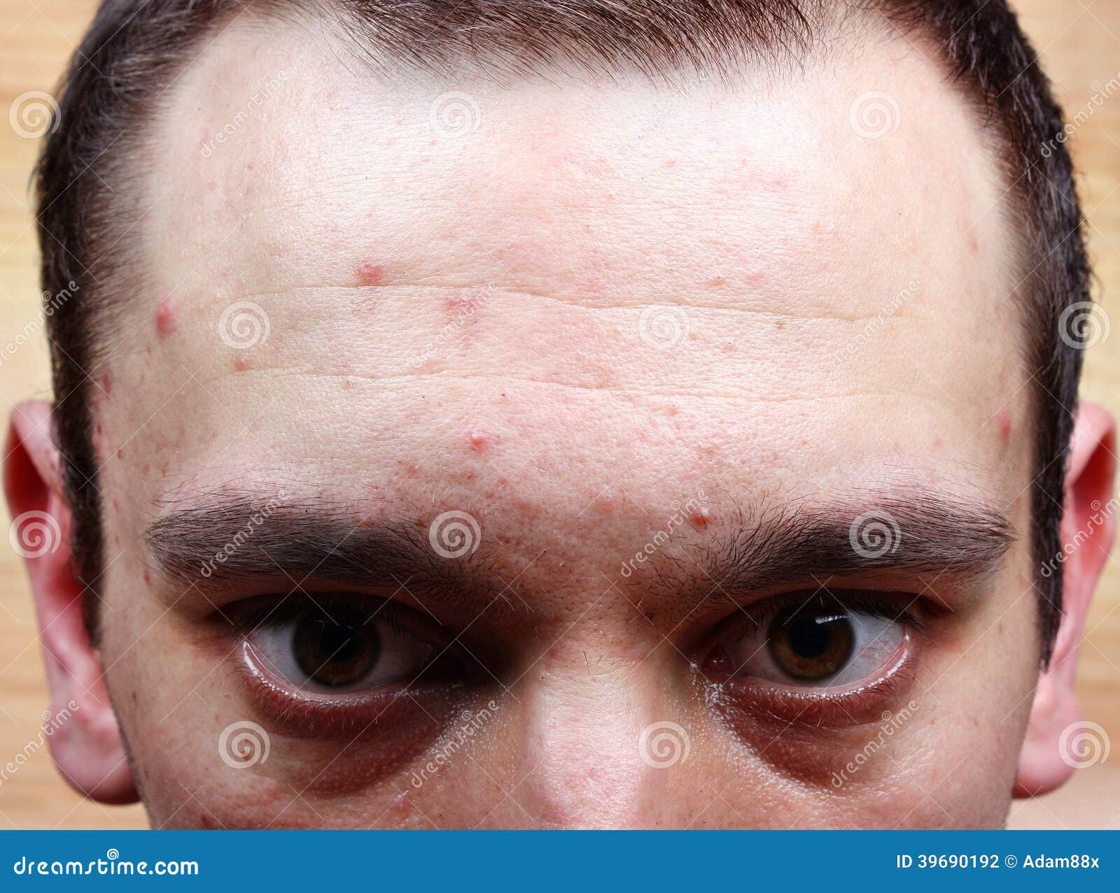 Boutons D'acné Sur Le Visage Photo stock - Image: 39690192
