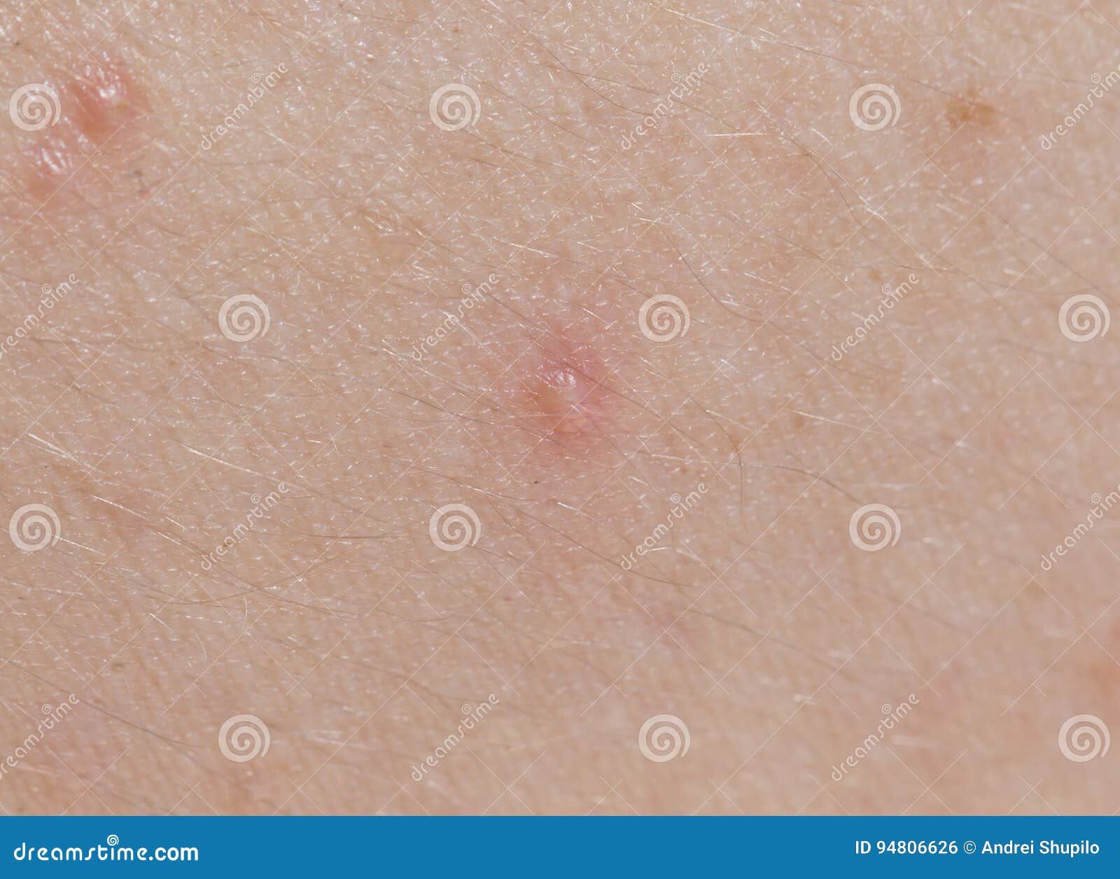 Boutons sur la peau fin photo stock. Image of rubrique - 94806626
