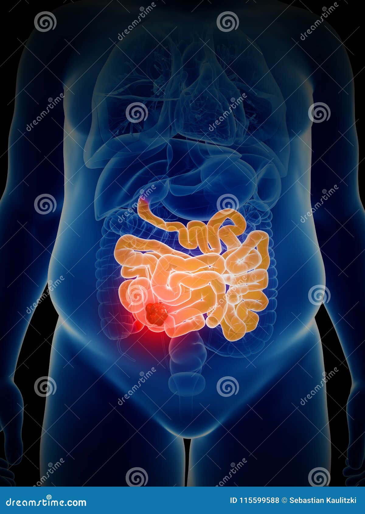 Bowel Cancer And Stoma Vector Illustration 24901420