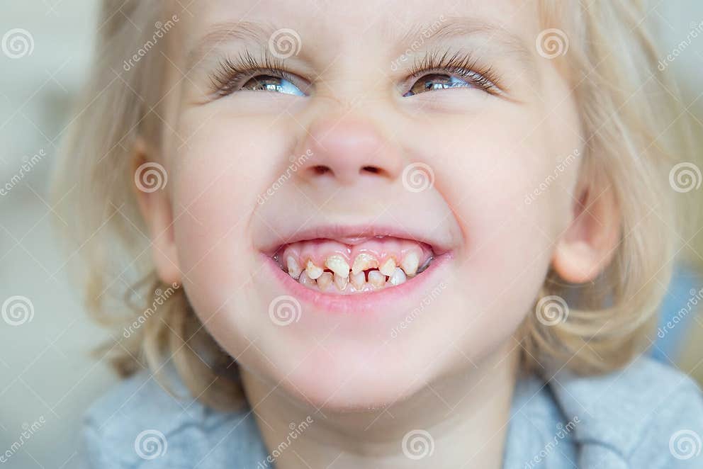 Boy. Bad teeth. stock photo. Image of cavity, healthy - 137136116