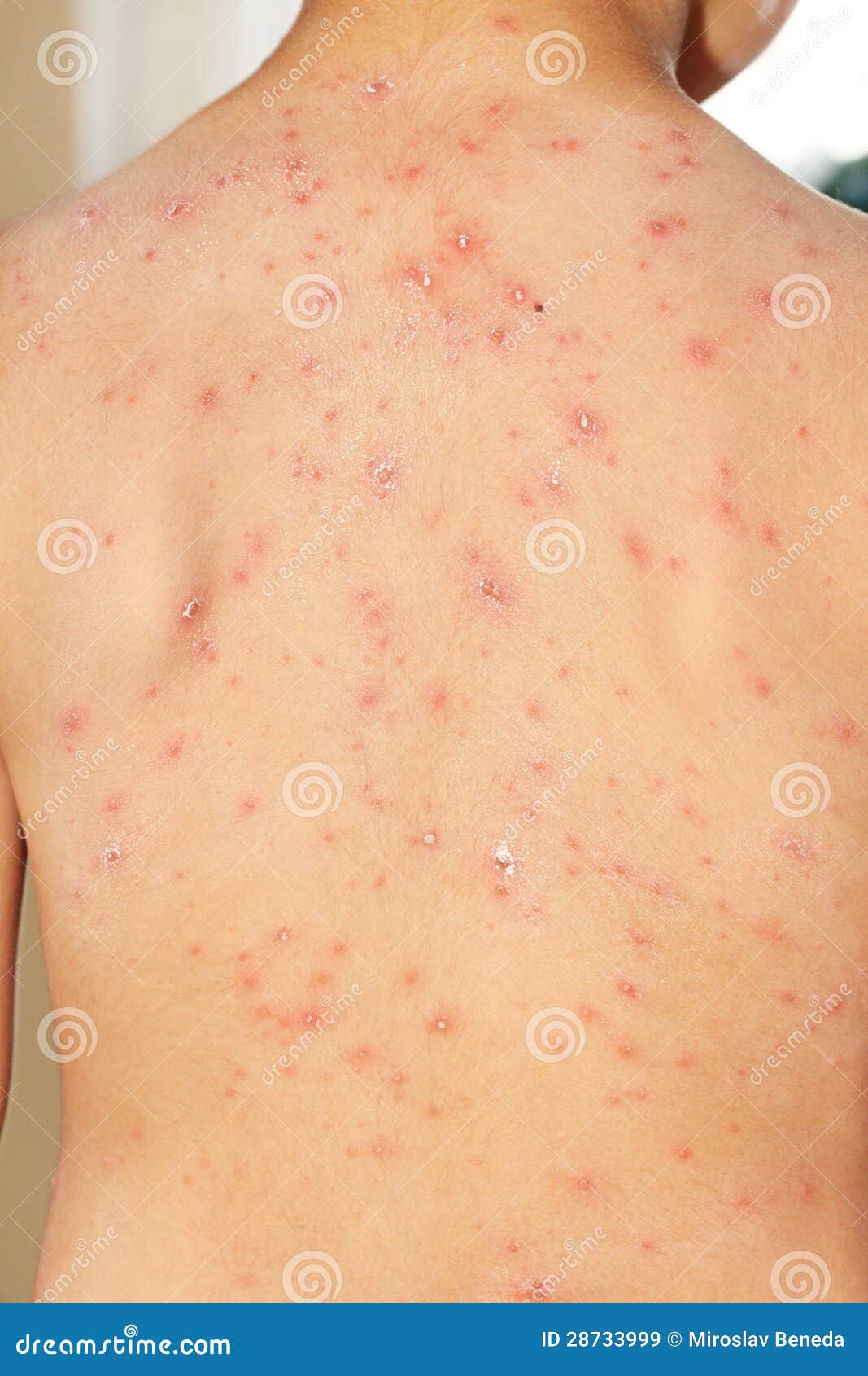 Boy with chicken pox stock image. Image of care, isolation - 28733999