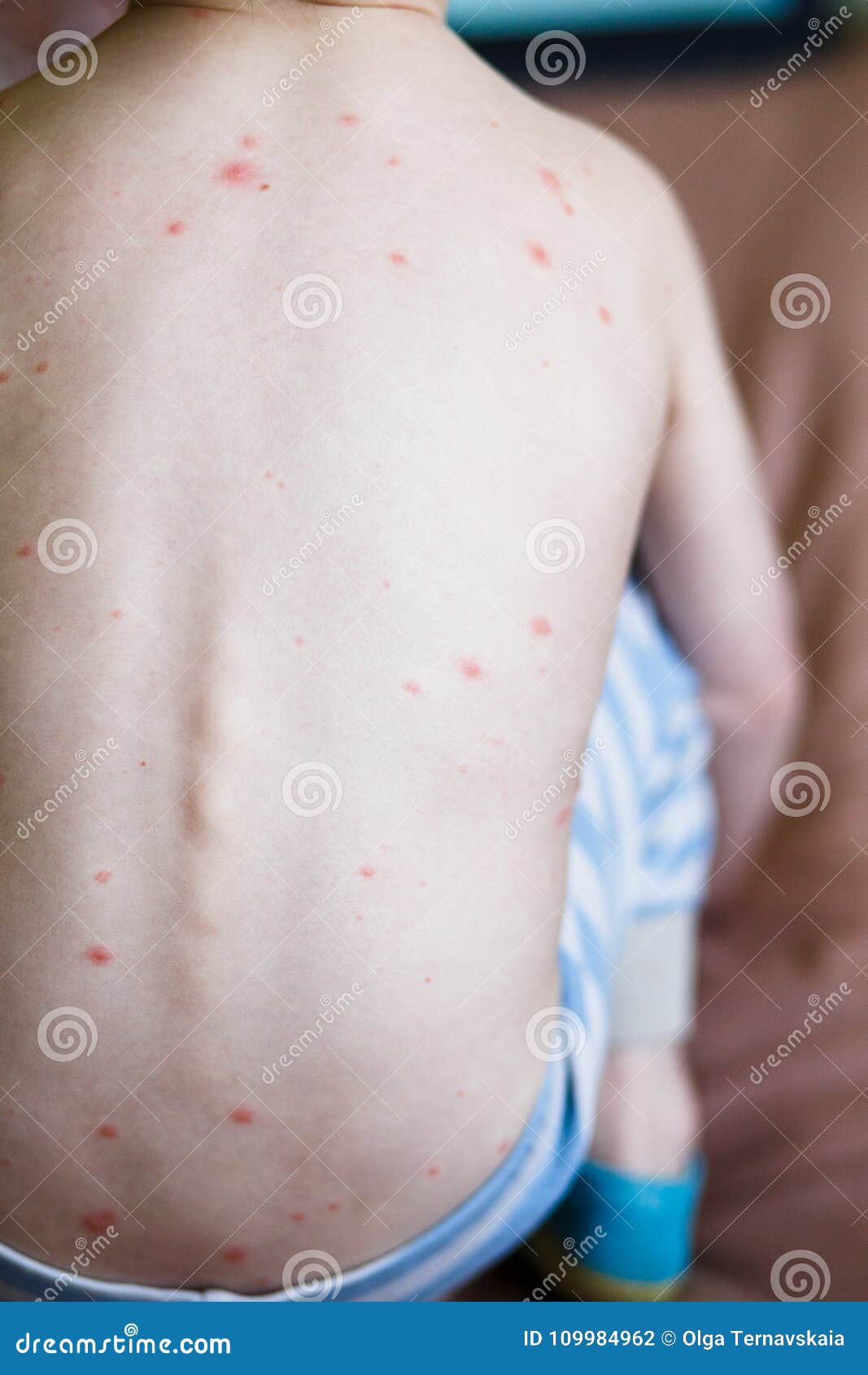 Boy with Chicken Pox Rashon on the Back. Vertical Photo Stock Photo ...