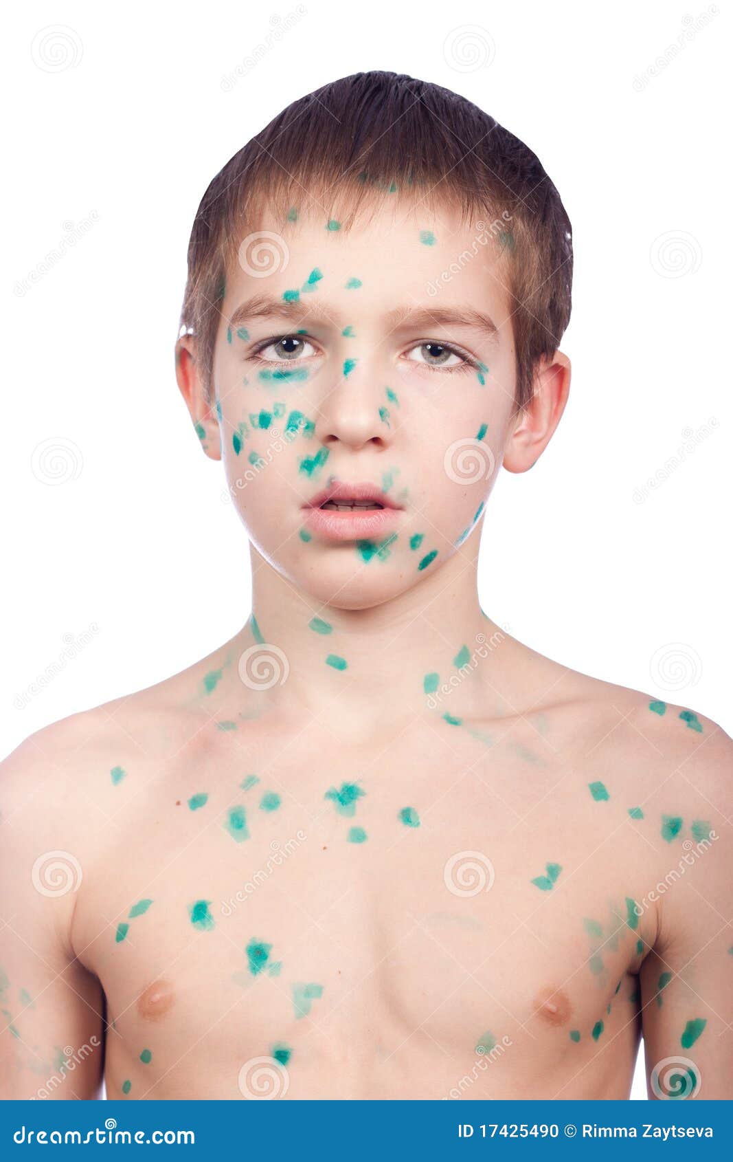 Boy with the Chickenpox s stock photo. Image of health - 17425490