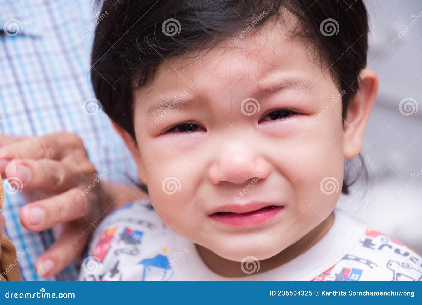 Boy Face Was Crying from Pain in Forehead from Impact. Bulging Head ...