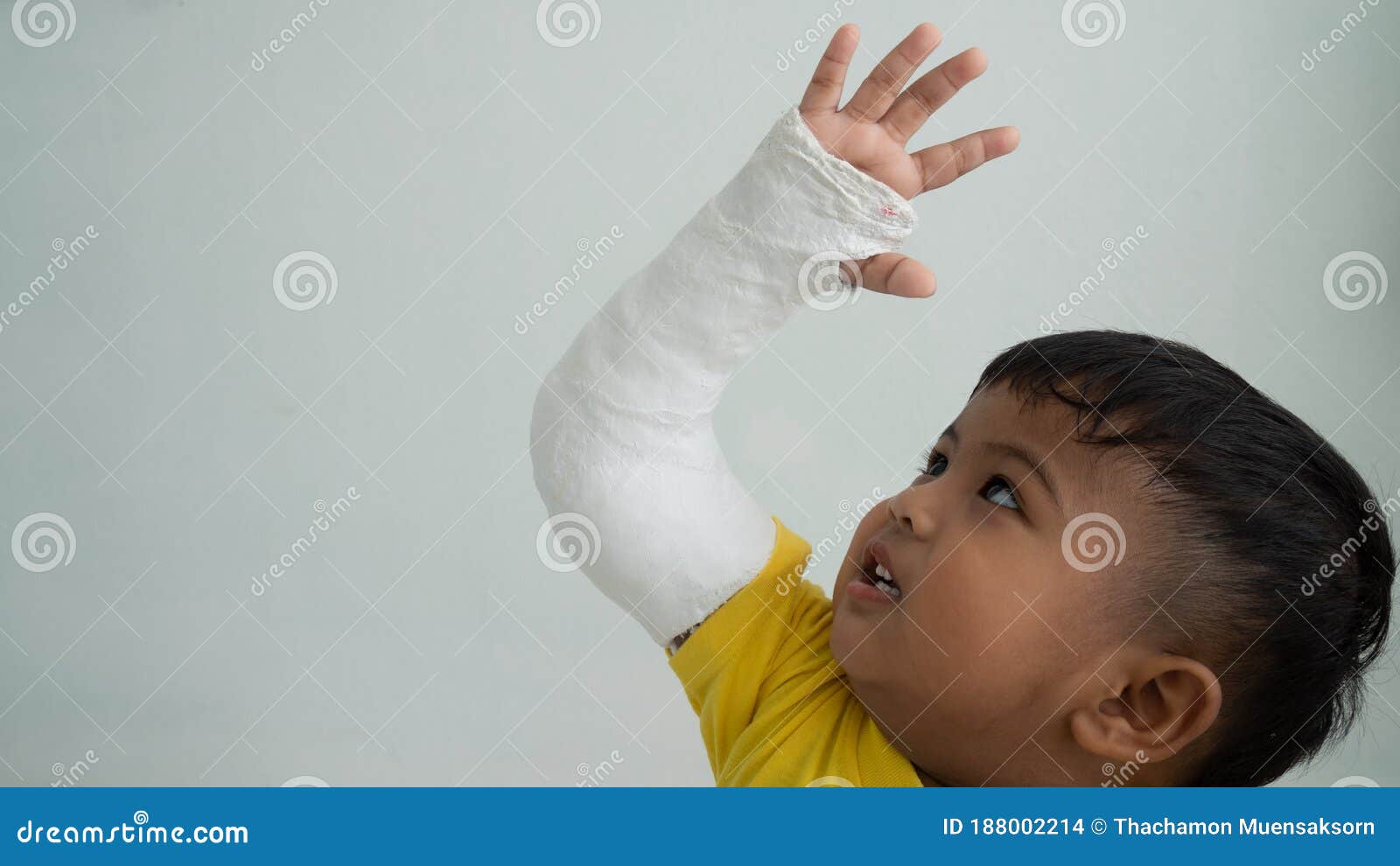 Boy Hand Bone Broken from Accident with Arm Splint Stock Photo - Image ...