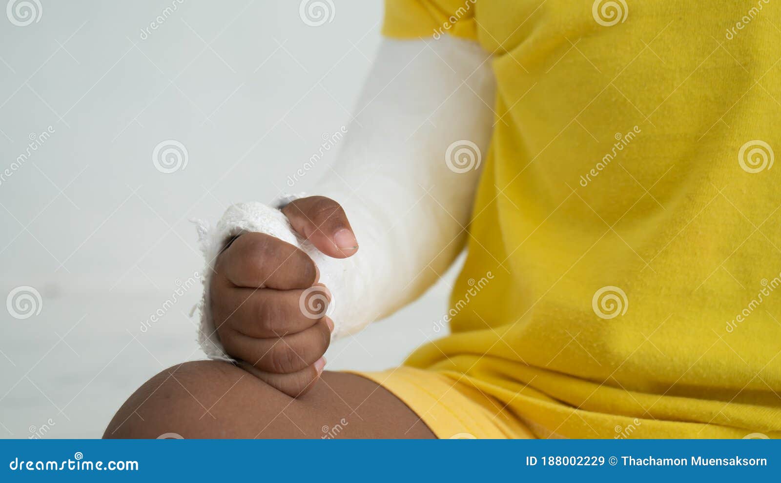 Boy Hand Bone Broken from Accident with Arm Splint Stock Image - Image ...