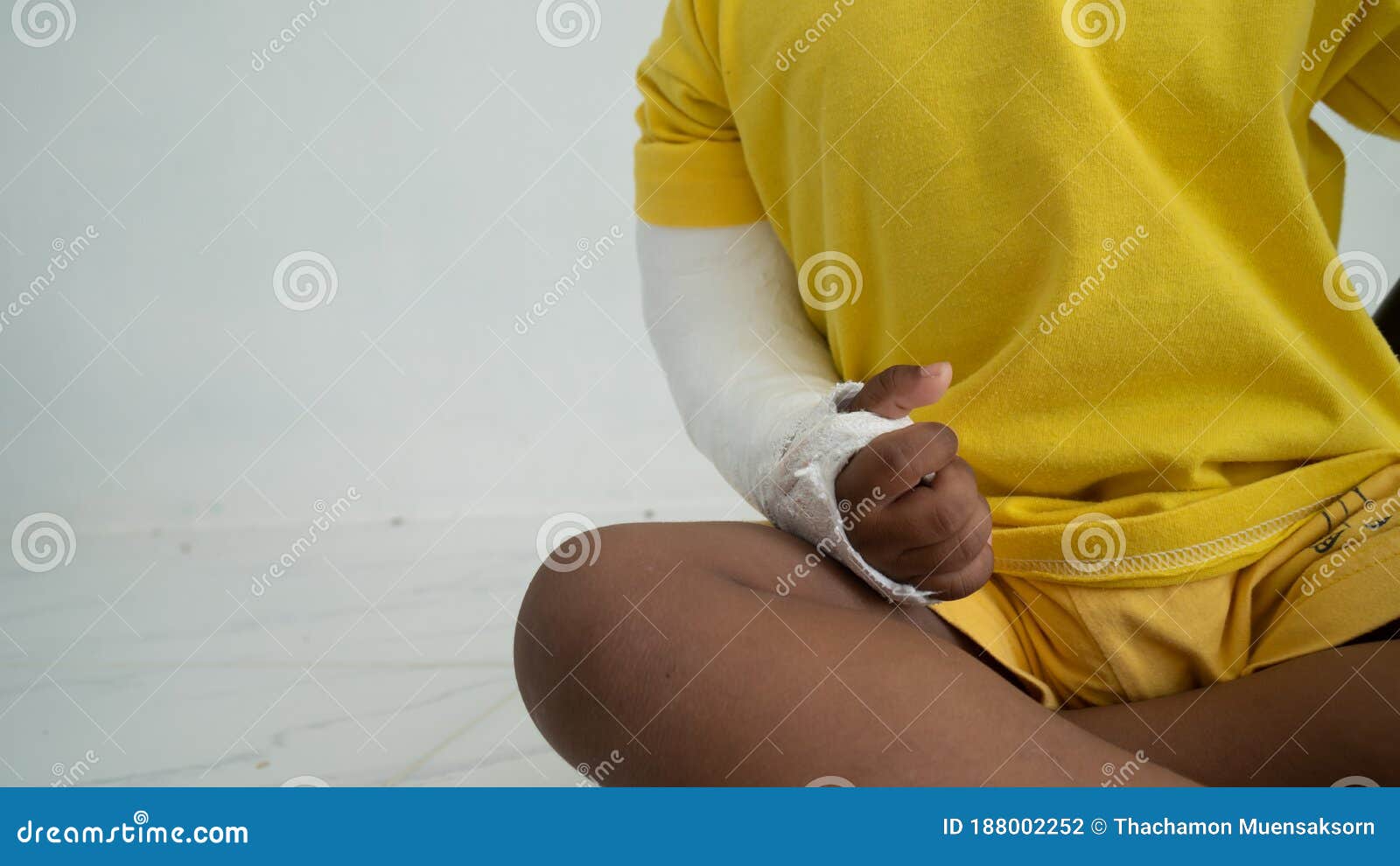Boy Hand Bone Broken from Accident with Arm Splint Stock Photo - Image ...