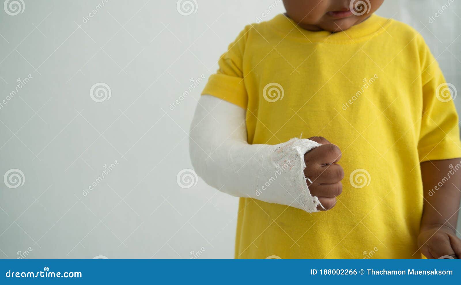 Boy Hand Bone Broken from Accident with Arm Splint Stock Photo - Image ...