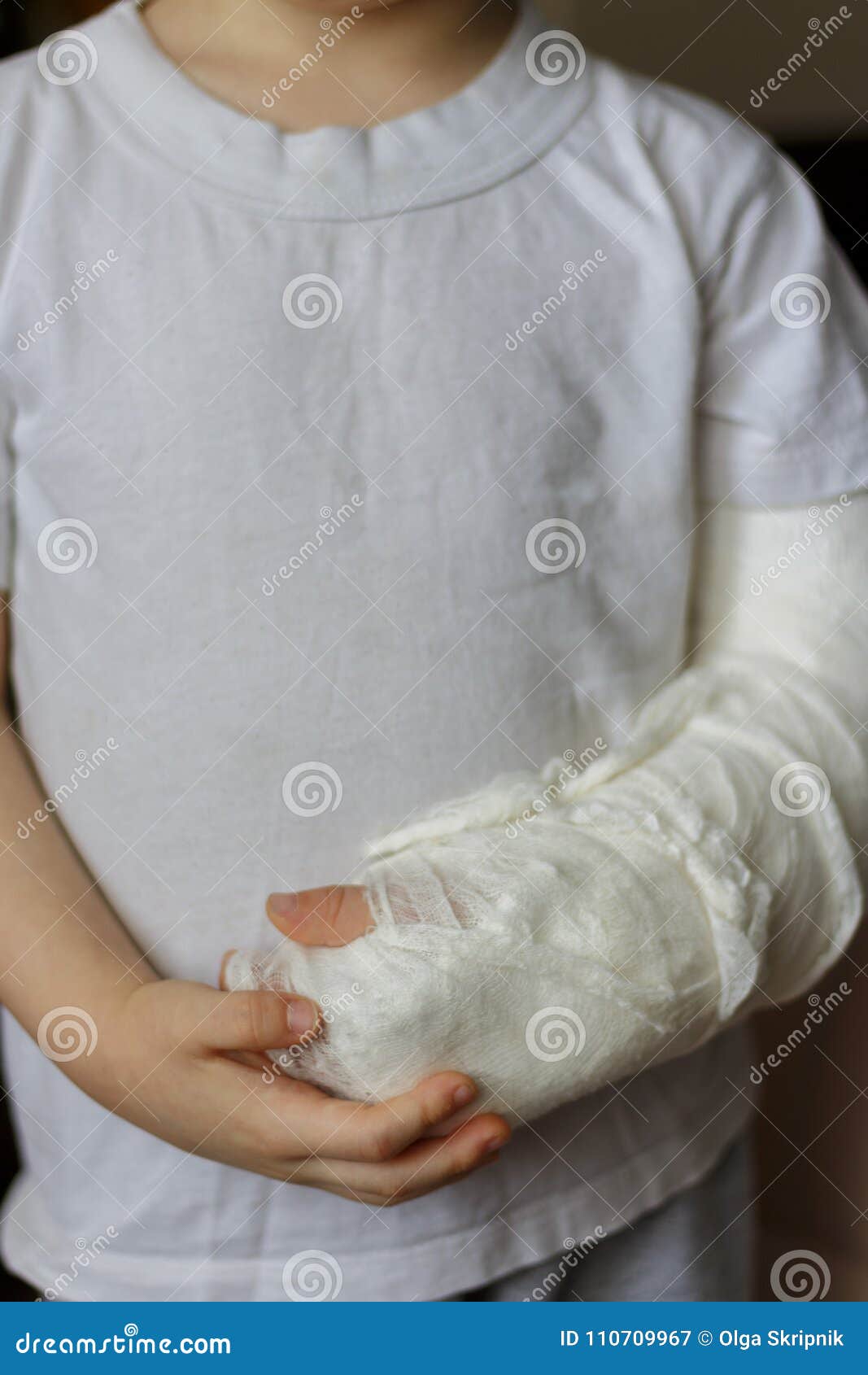 Broken child`s hand stock image. Image of patient, kids - 110709967