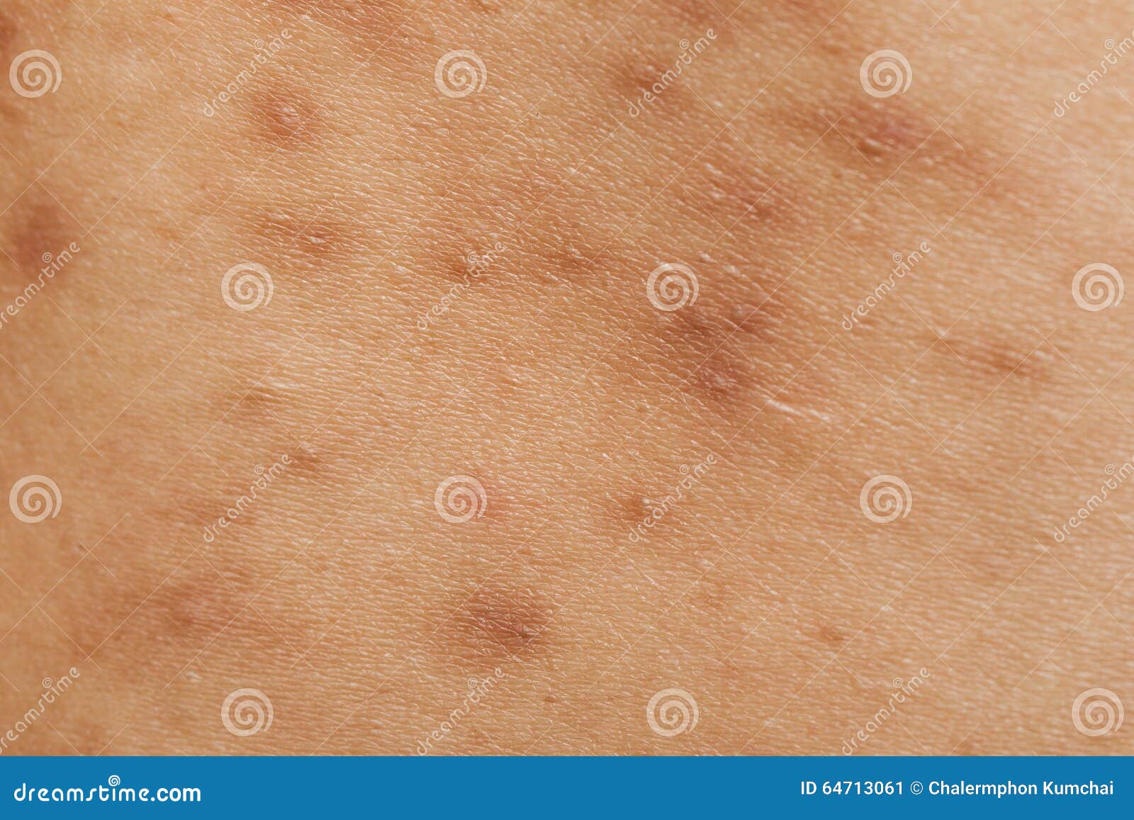 Dry Scars On The Back Of An Old Woman, Tan Separately On A White ...