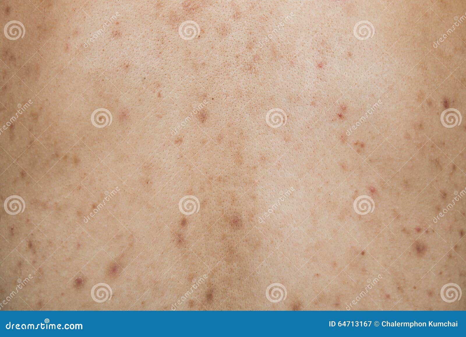 Problematic Human Skin With Pimples Royalty-Free Stock Photography ...