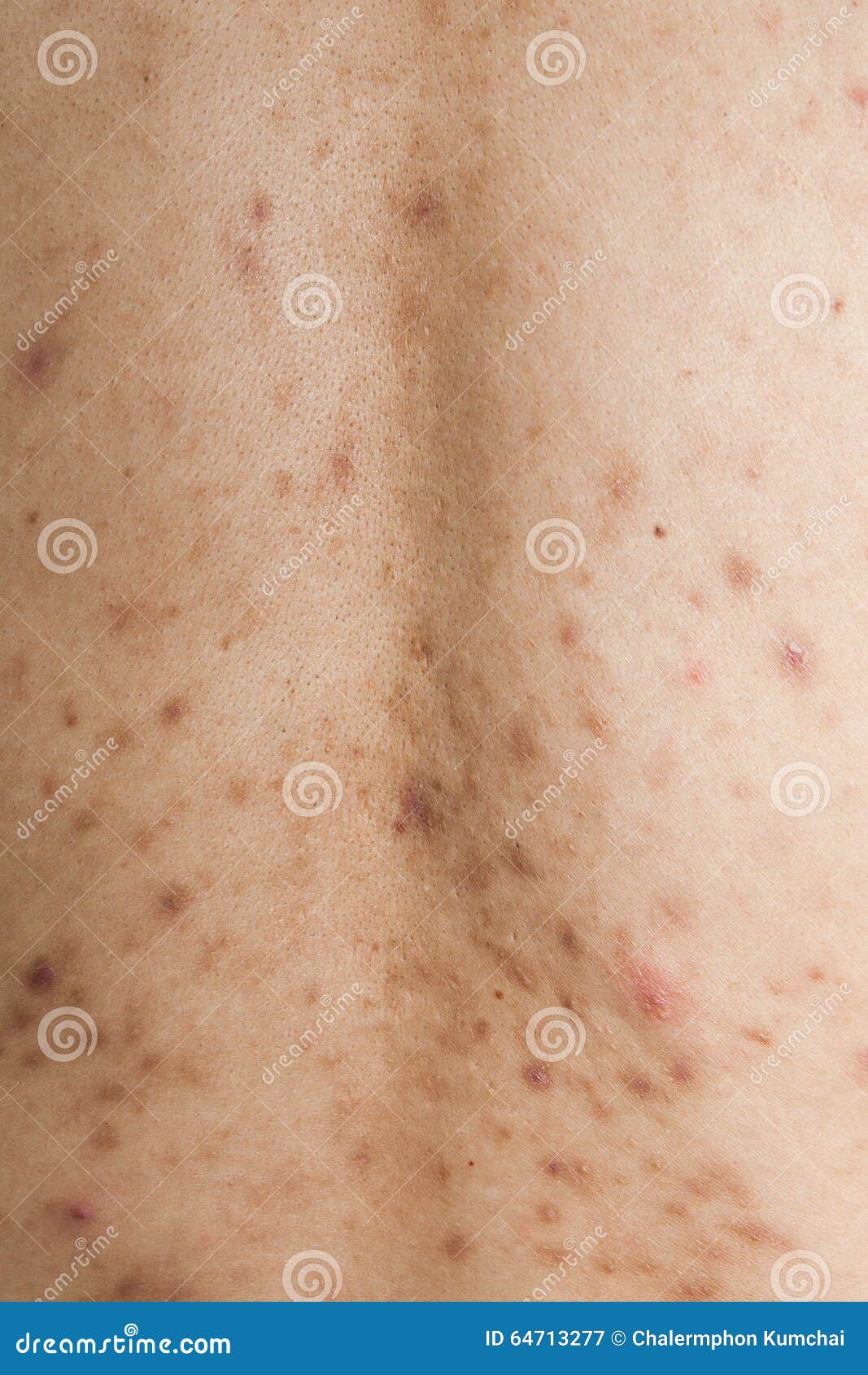Boy with Problematic Skin and Acne Scars Stock Image - Image of people ...
