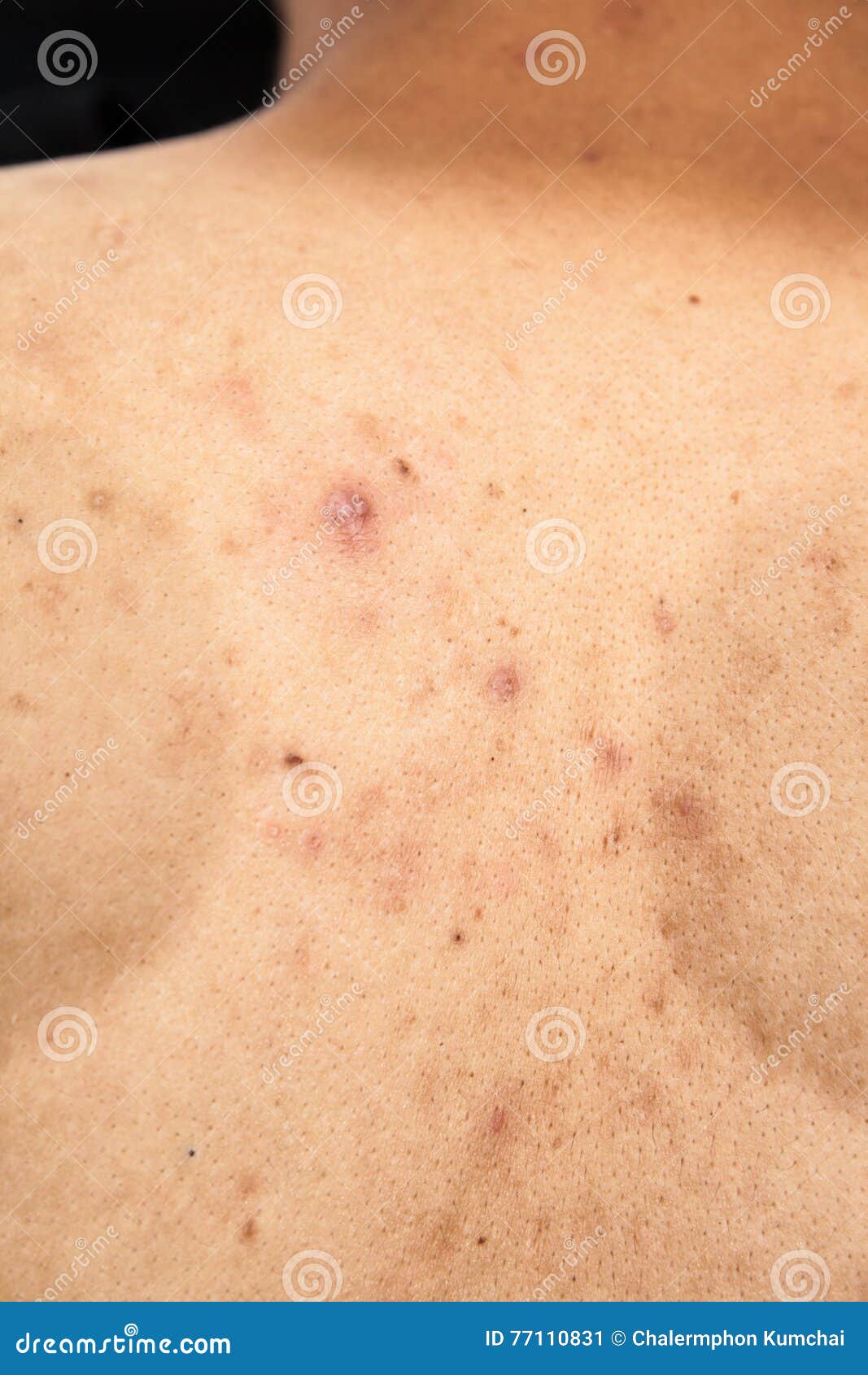Boy with Problematic Skin and Acne Scars Stock Image - Image of medical ...