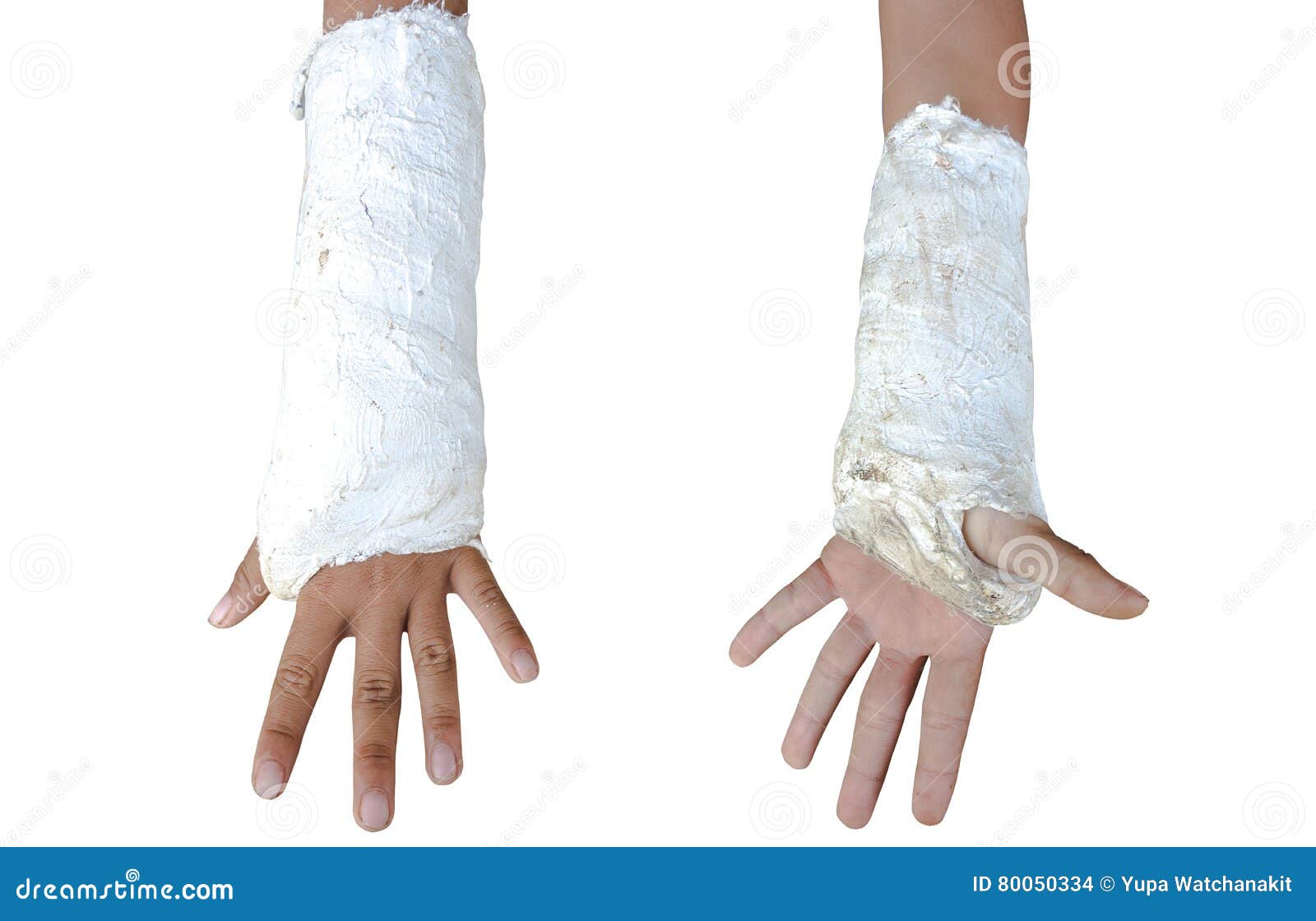 Boy s broken arm in cast stock photo. Image of pain, treatment - 80050334
