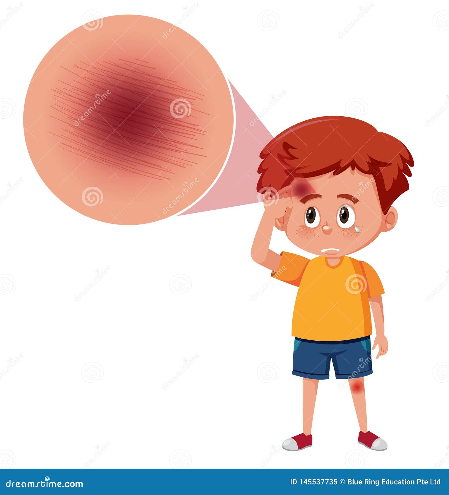 Scab Stock Illustrations – 200 Scab Stock Illustrations, Vectors ...