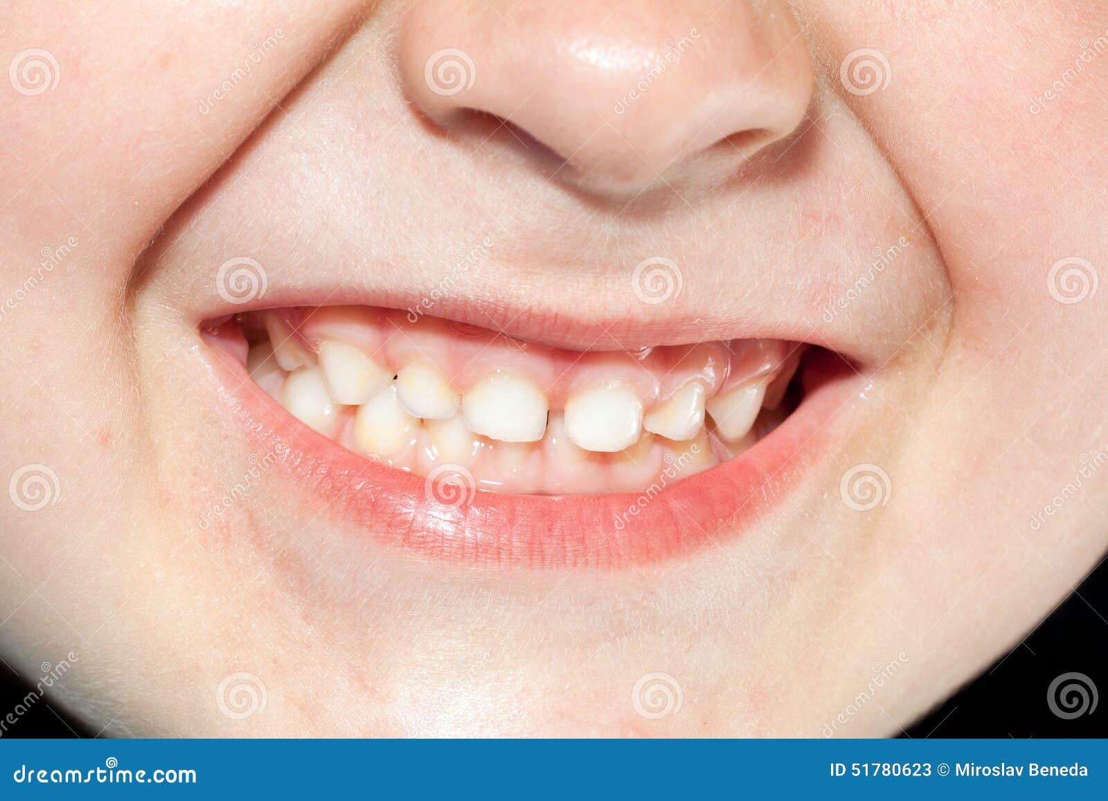 Boy with teeth stock image. Image of cheek, loss, male - 51780623