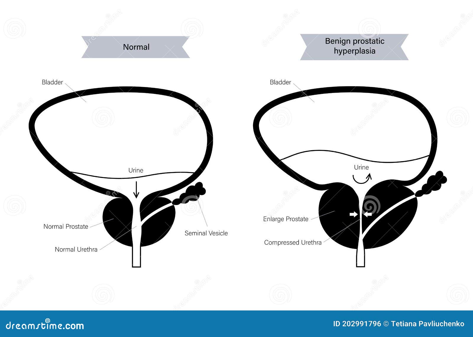 BPH info concept stock vector. Illustration of aging - 202991796