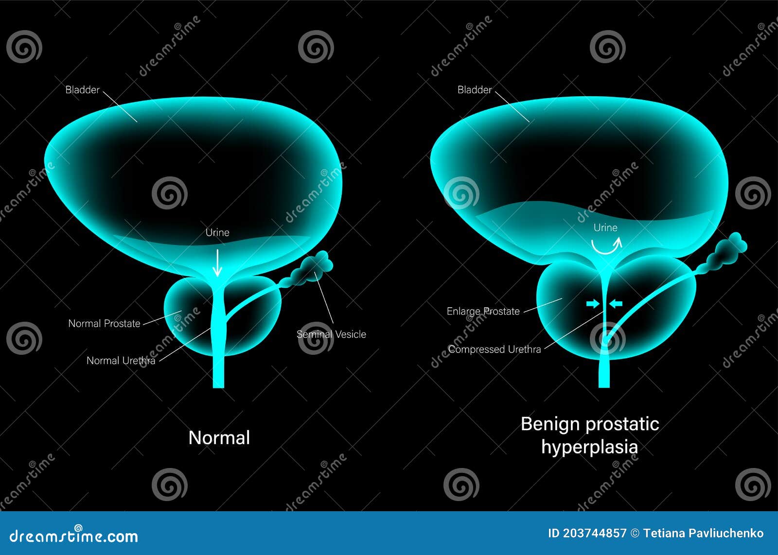 BPH info concept stock illustration. Illustration of prostate - 203744857