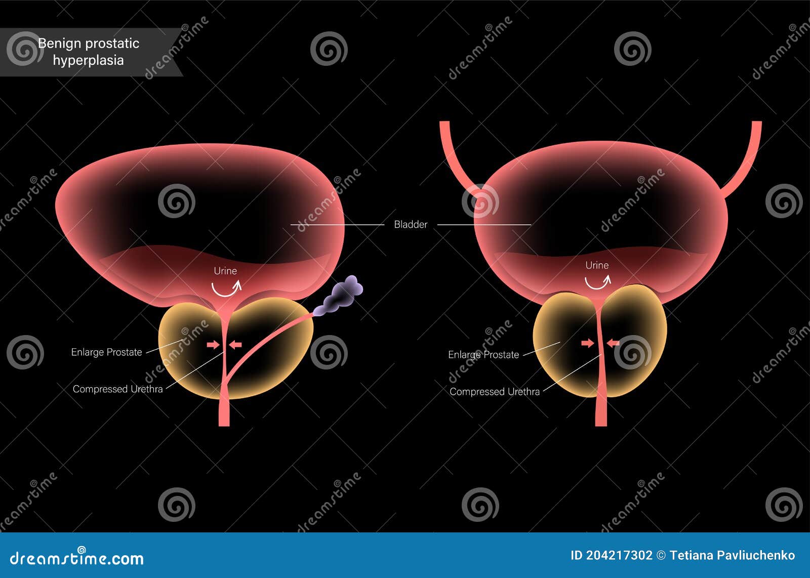 BPH info concept stock vector. Illustration of black - 204217302