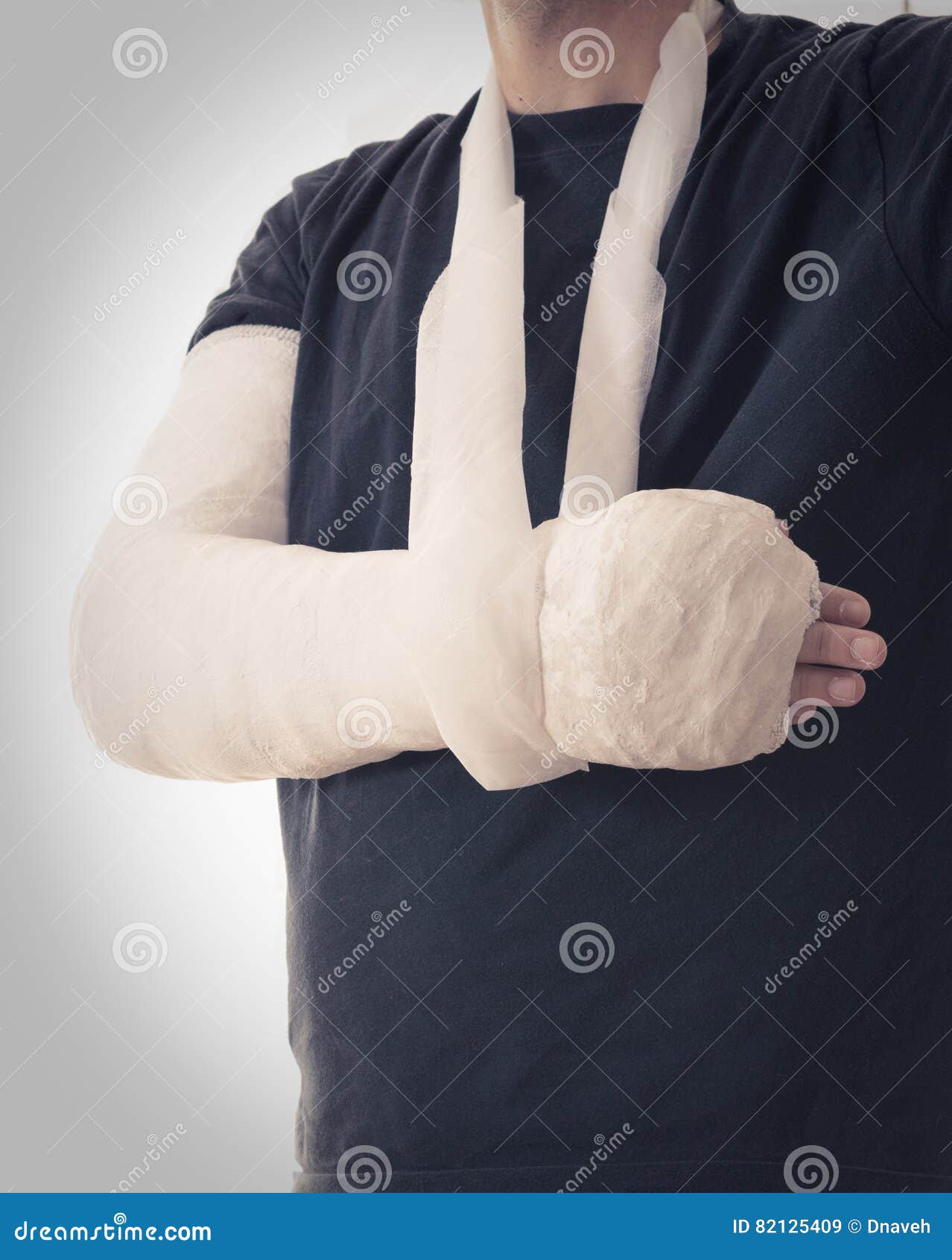 Braço Quebrado No Molde E No Estilingue Brancos De Emplastro Imagem de ...