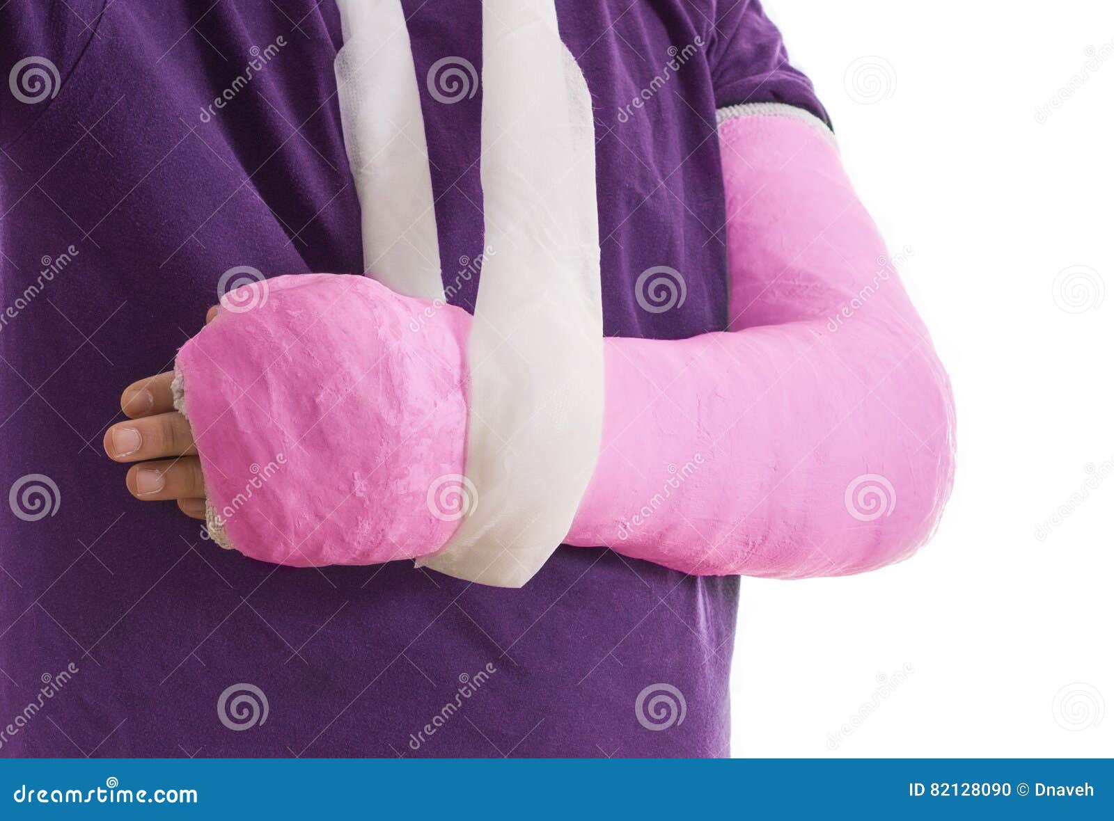 Braço Quebrado No Molde E No Estilingue Cor-de-rosa De Emplastro Foto ...