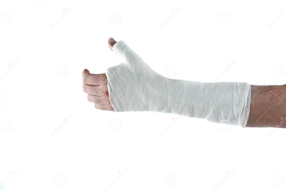 Braccio in gesso fotografia stock. Immagine di carpale - 43468642