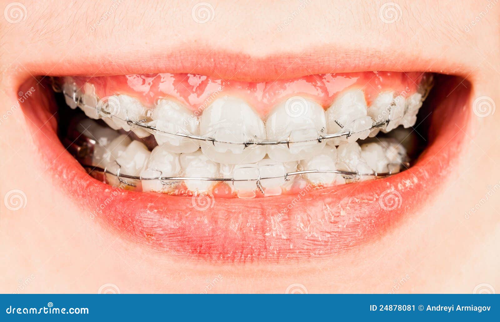 Braces stock image. Image of smiling, healthy, dental - 24878081