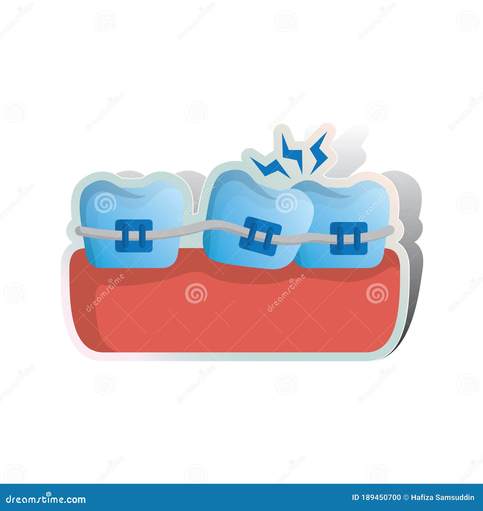 Braces for Fixing Unaligned Teeth. Vector Illustration Decorative ...