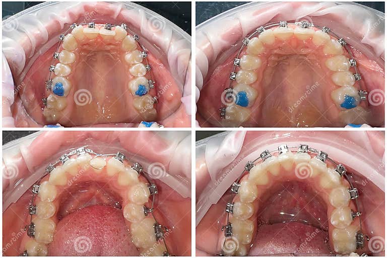 Before and after Braces are Installed. Upper and Lower Jaw Stock Photo ...