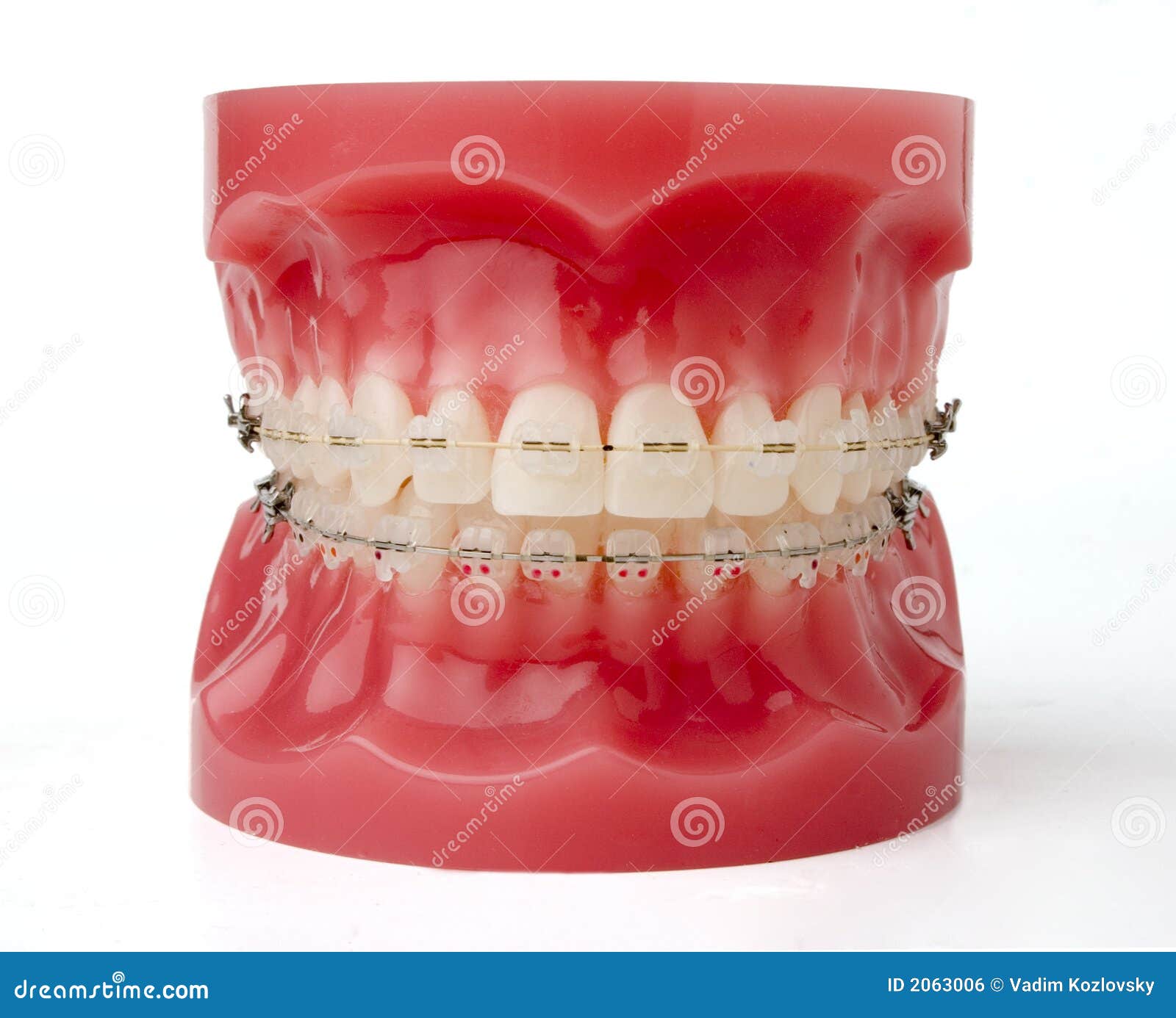 Braces model stock photo. Image of metal, appearance, cosmetic - 2063006