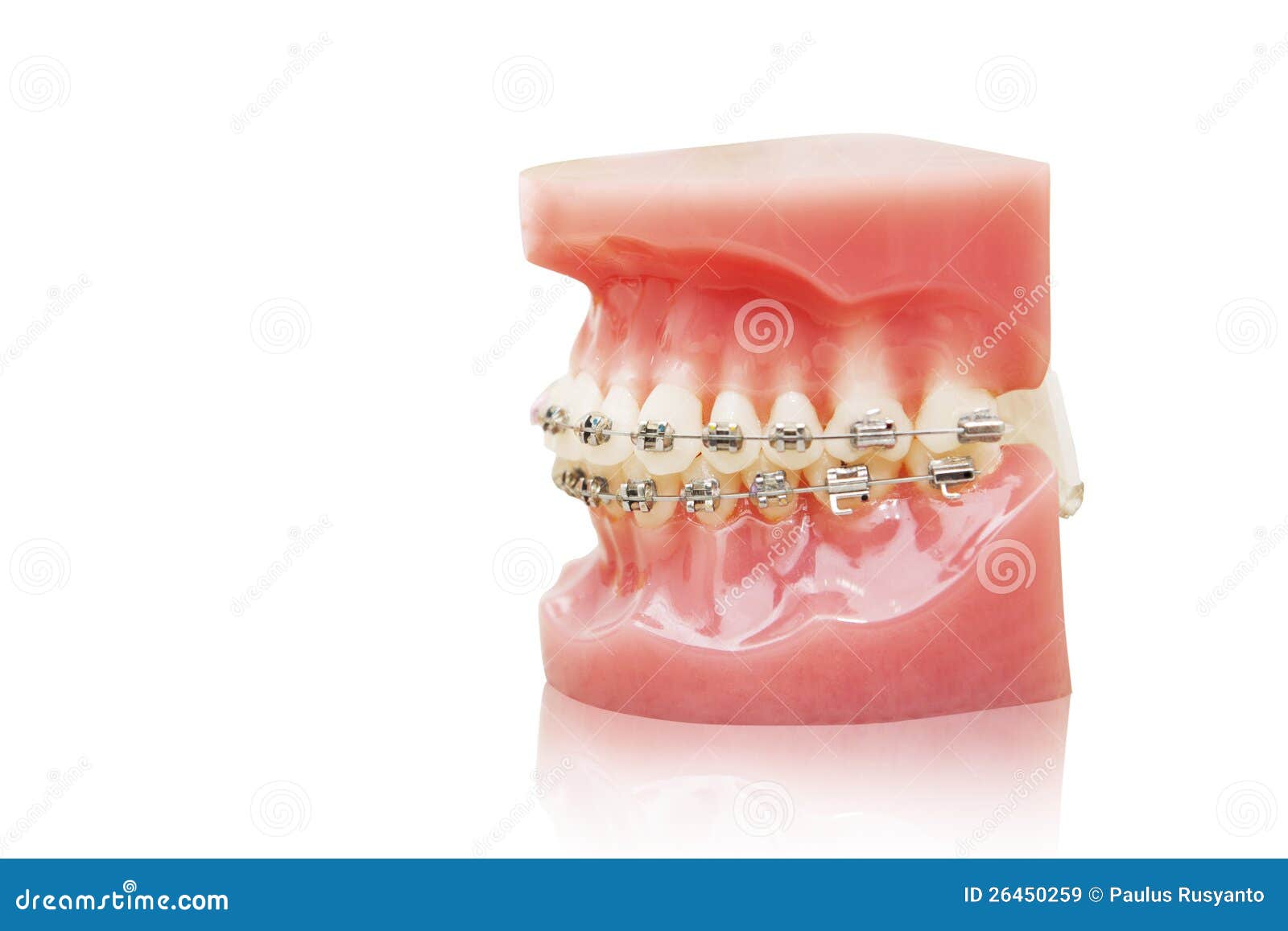 Braces model stock image. Image of brackets, orthodontic - 26450259