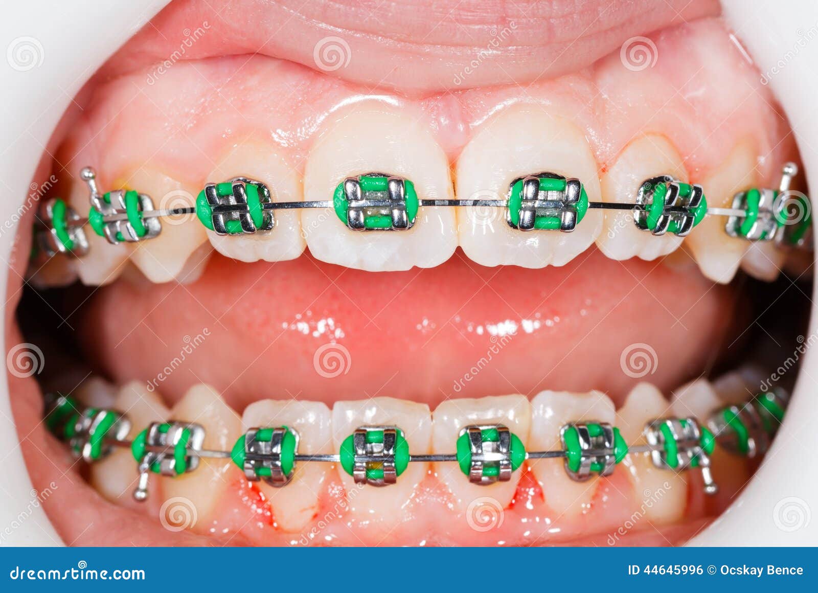 Braces on teeth stock photo. Image of bracket, bite, gums - 44645996