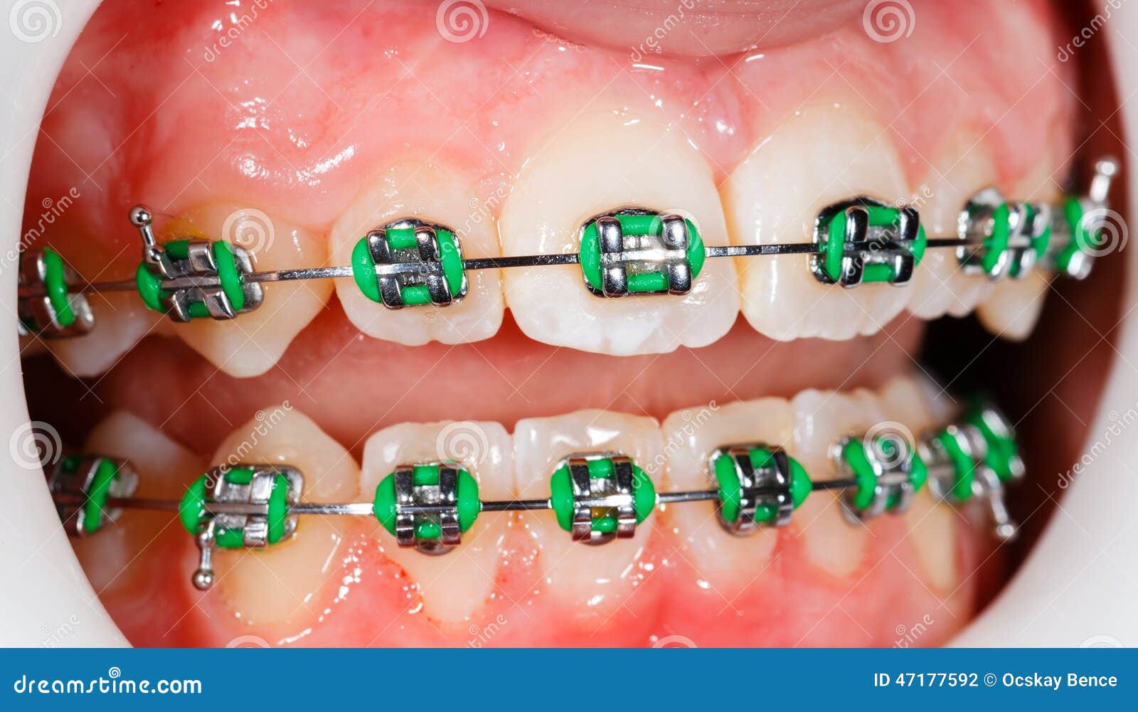 Braces on teeth stock photo. Image of mouth, dentistry - 47177592