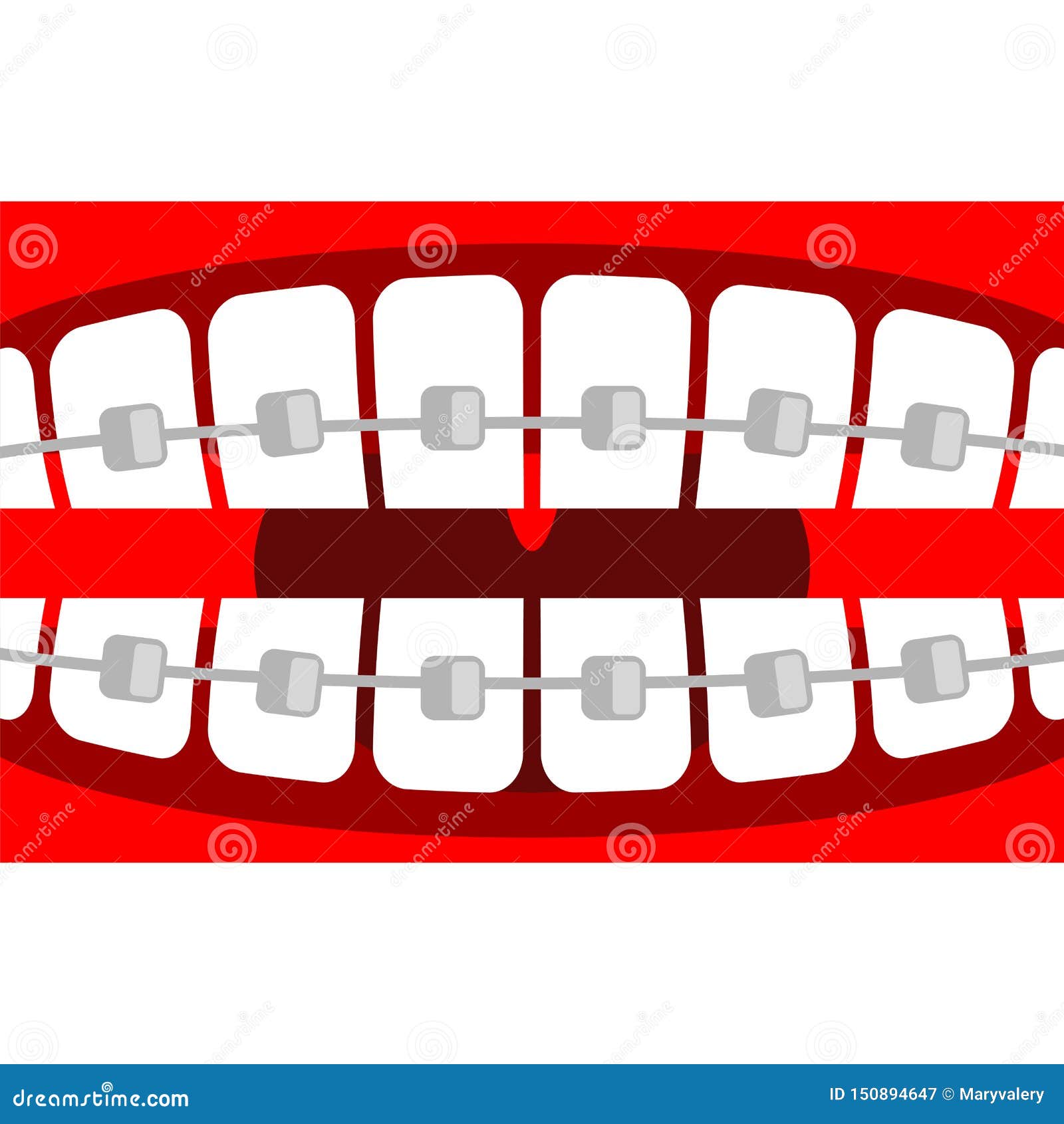 Mouth With Tooth Braces And Tongue. Smiling Face. Healthy Teeth Brace ...