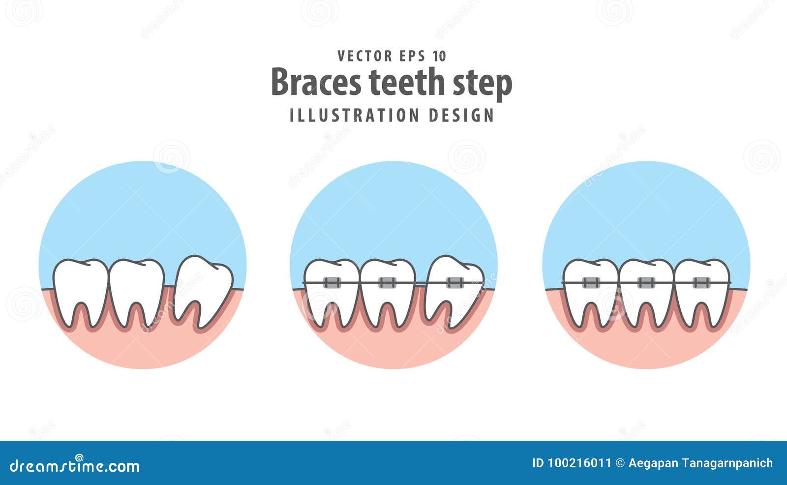 Braces Teeth Step in Circle Illustration Vector on White Stock Vector ...