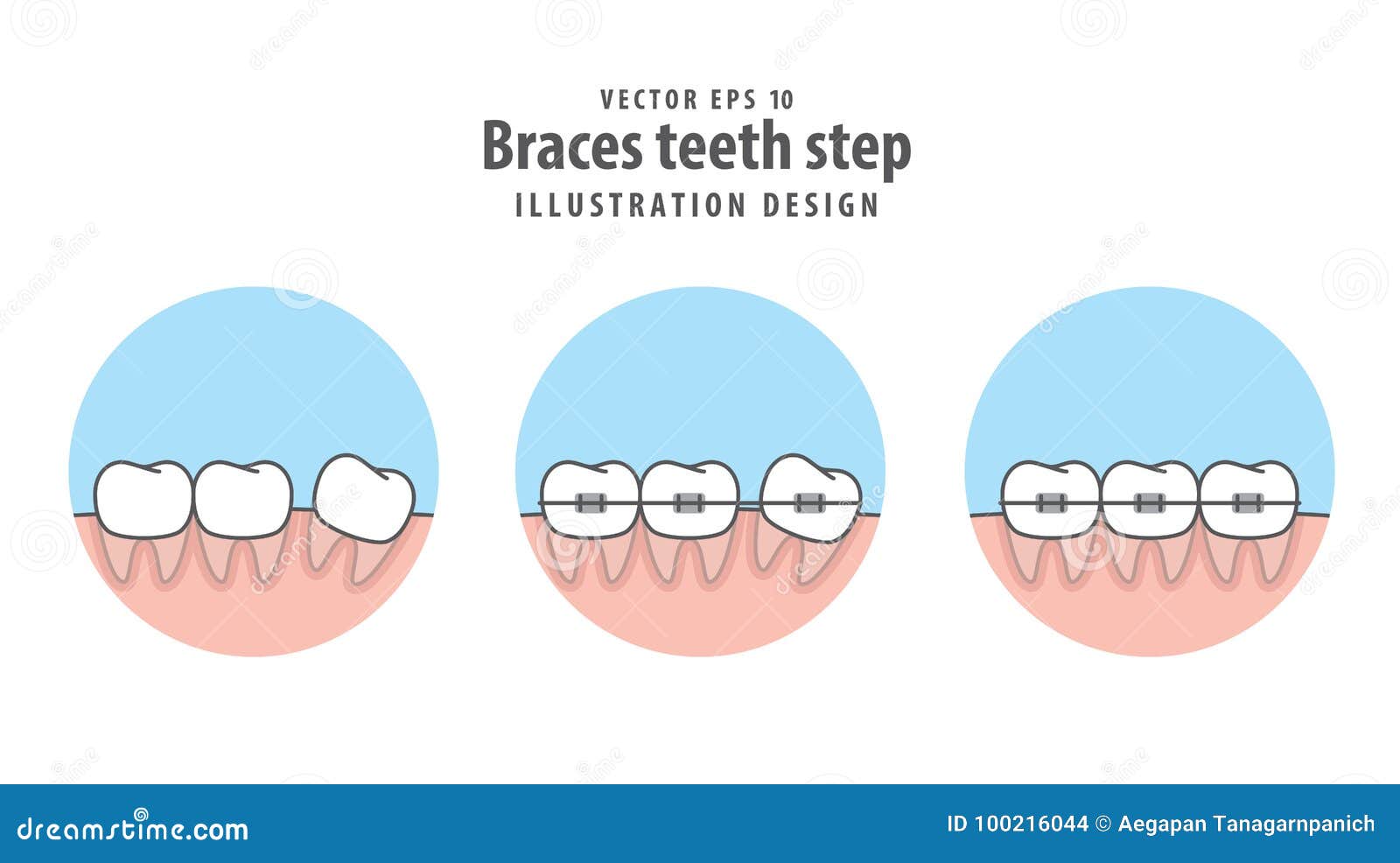 Braces Teeth Step in Circle Illustration Vector on White Stock Vector ...